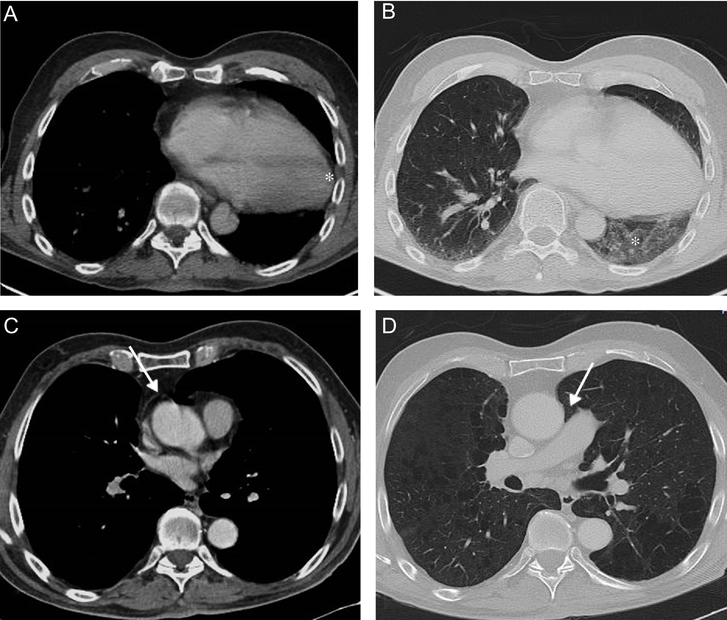 Delayed Incidental Diagnosis of Posttraumatic Cardiac Herniation ...