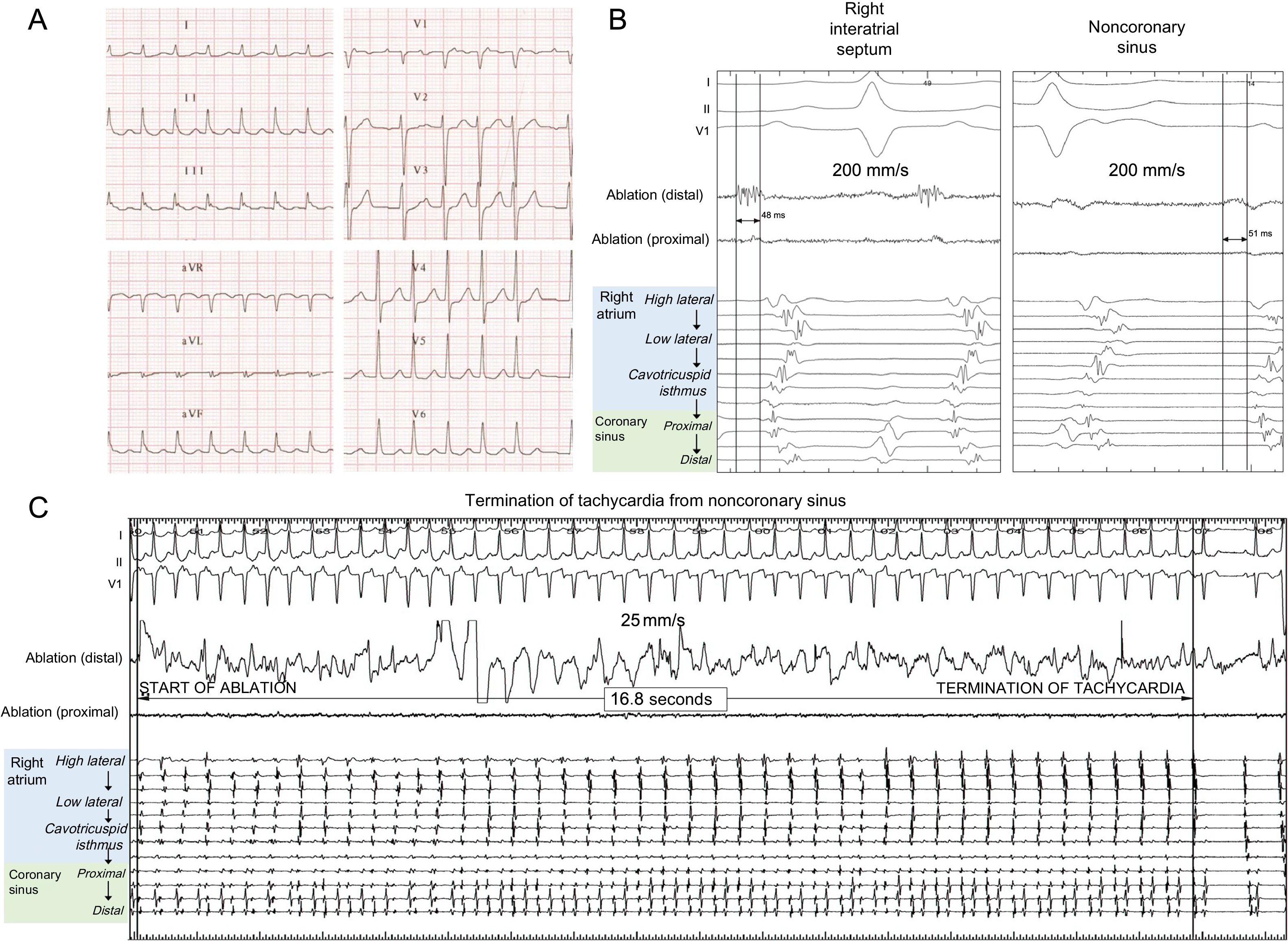 Catheter Ablation of Peri-Hisian Atrial Tachycardia From the ...