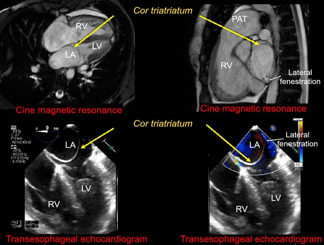 Abnormal Pulmonary Venous Drainage With Cor Triatriatum - Revista ...