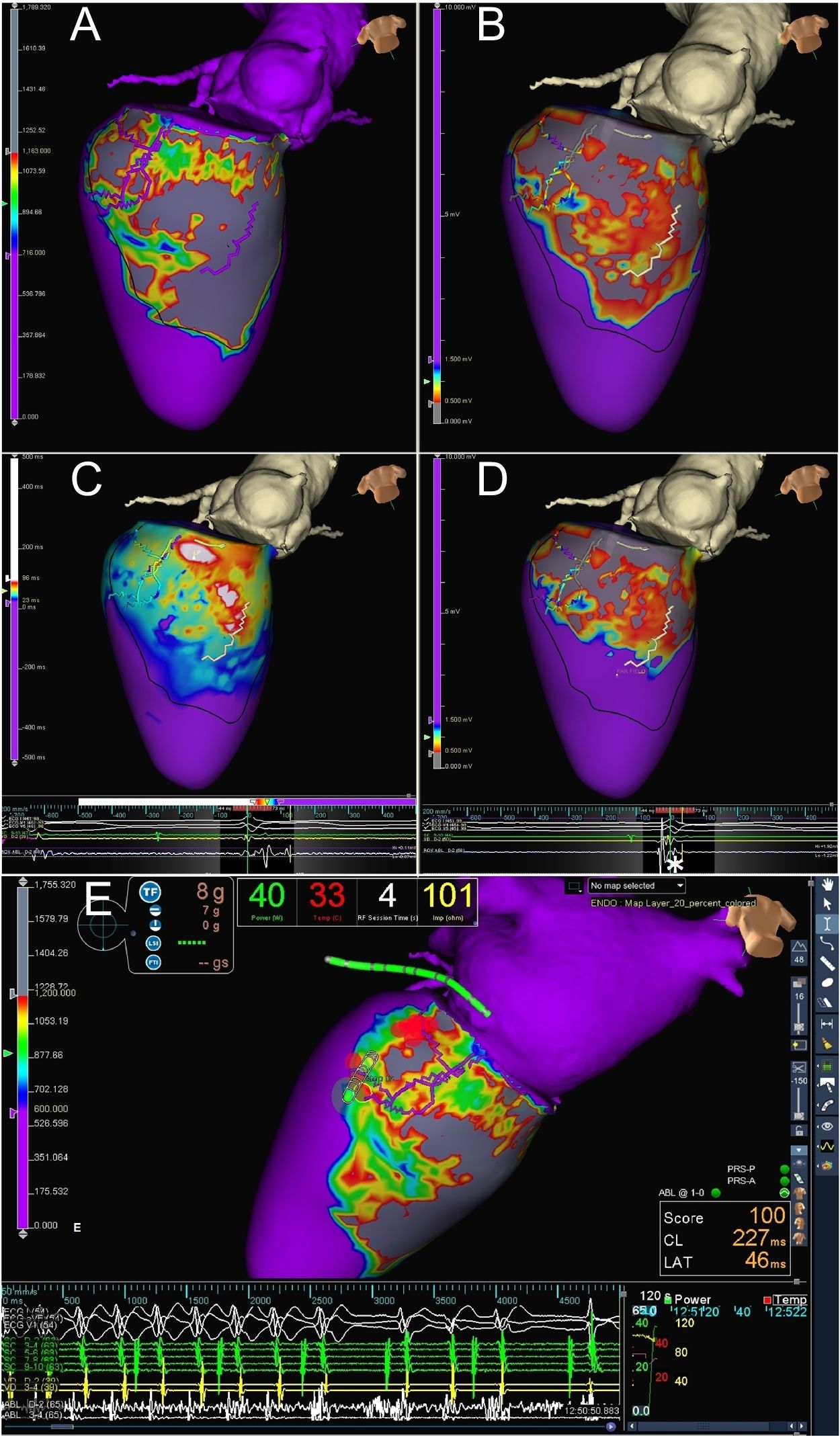 Ventricular Tachycardia Ablation Guided by Cardiac Magnetic Resonance ...