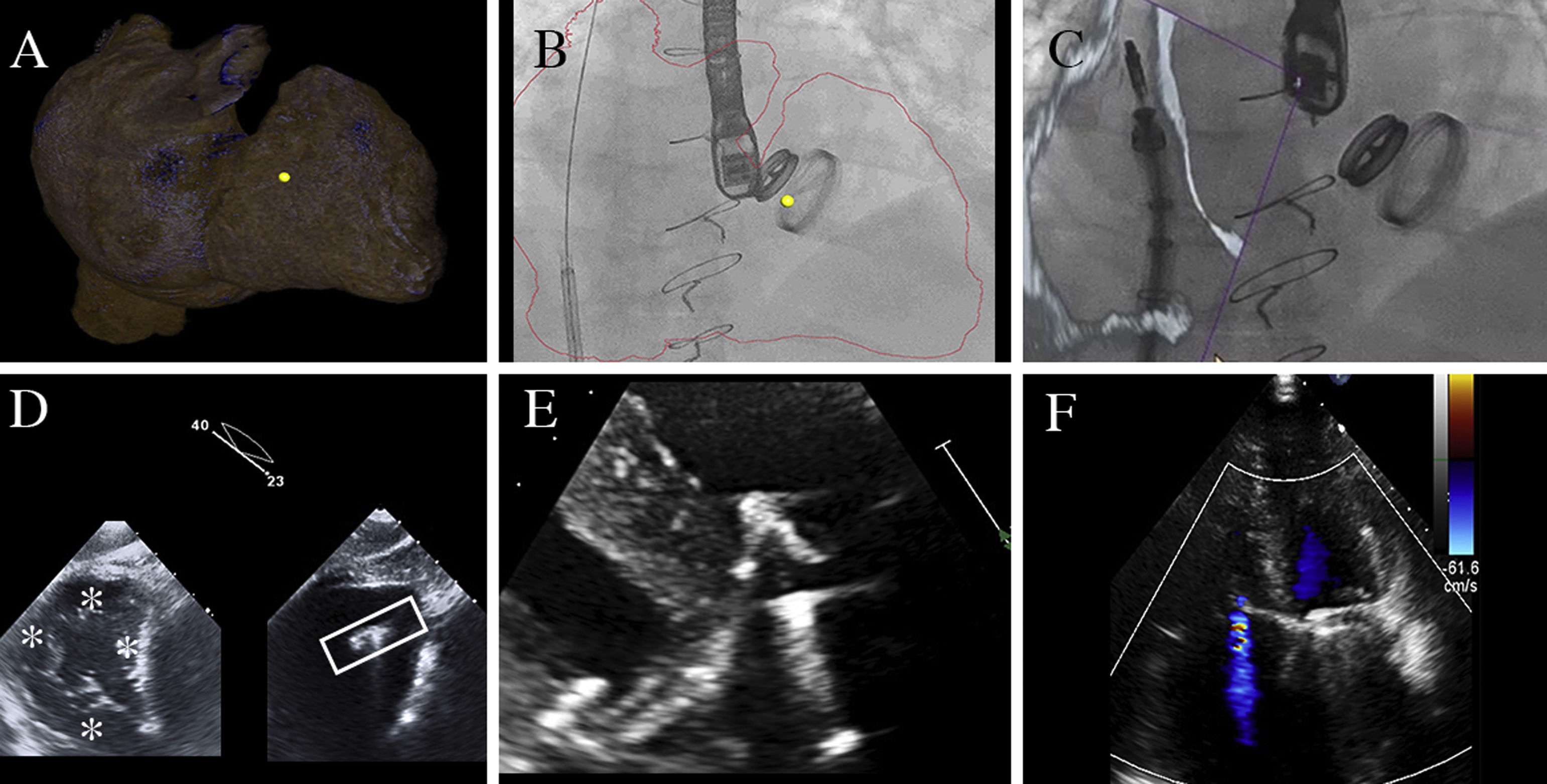 Multimodality and Fusion Imaging in Percutaneous Therapy of Tricuspid ... Multimodality and Fusion Imaging in Percutaneous Therapy of Tricuspid ...