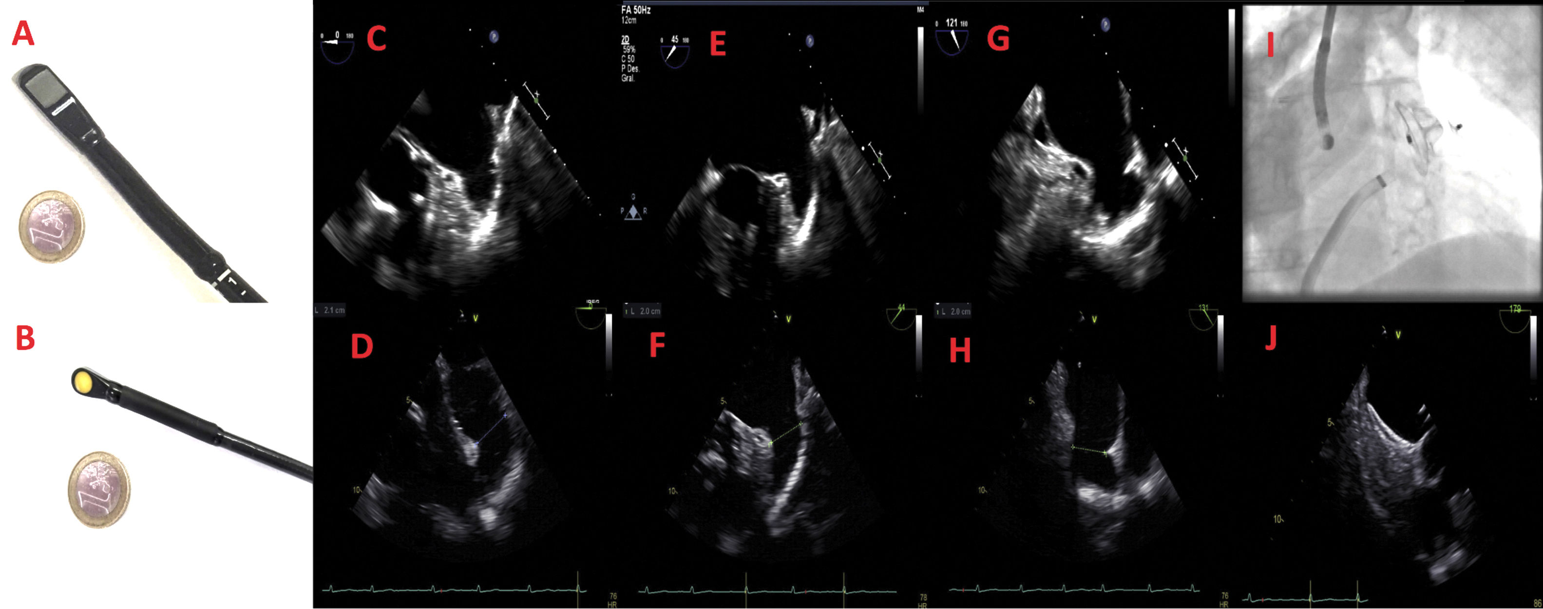 Minimally-invasive Transesophageal Echocardiography for Left Atrial ...