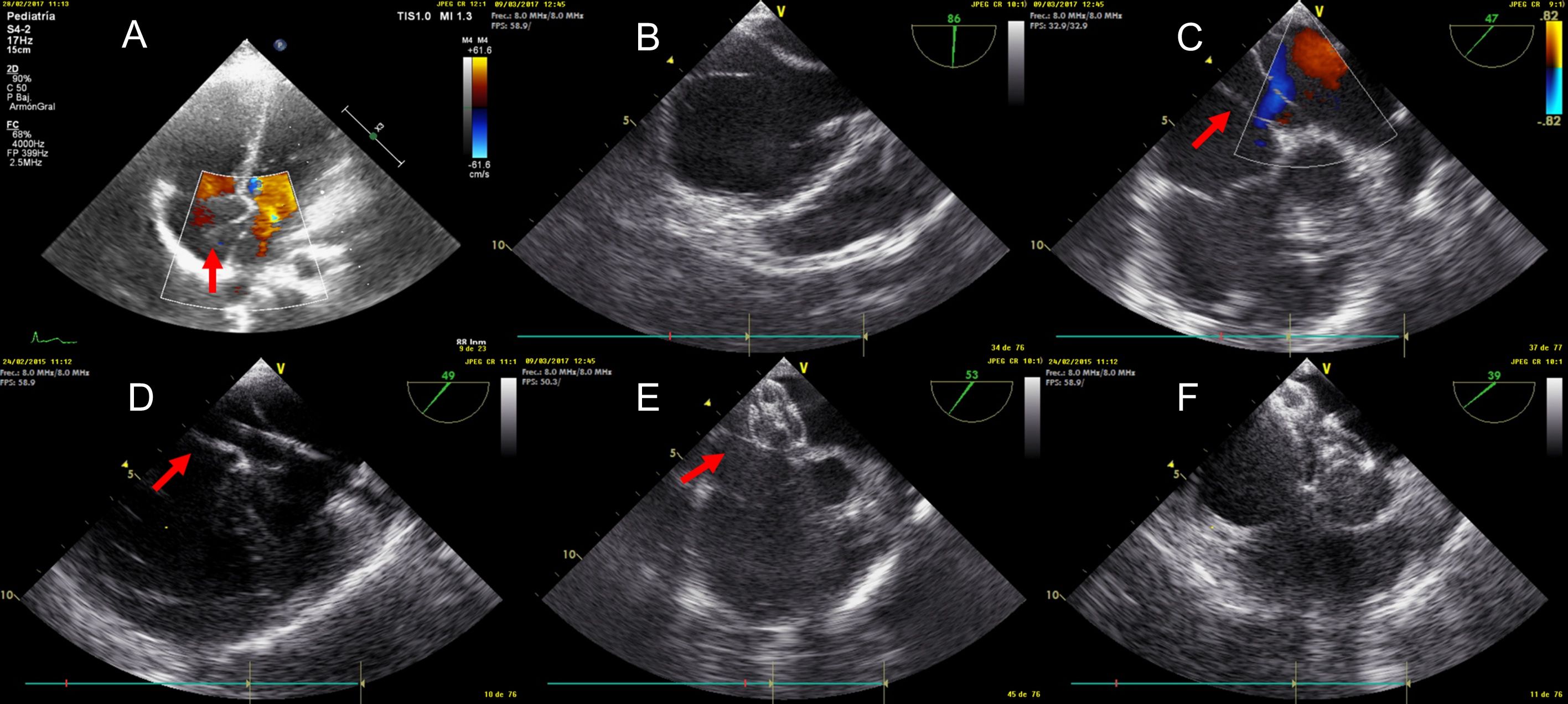 Incomplete Cor Triatriatum Dexter: An Unsettling Guest in the ...