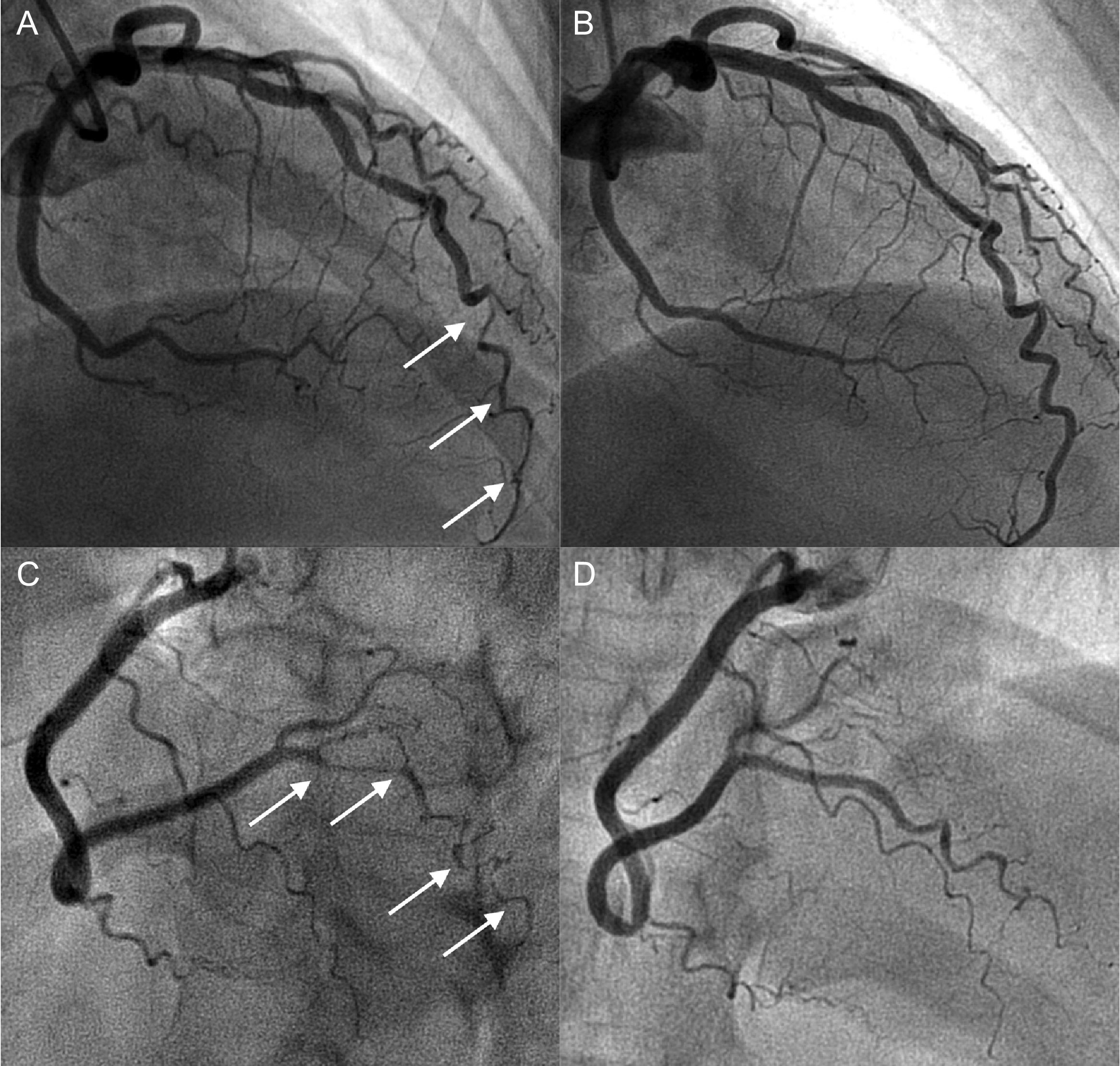 spontaneous artery dissection