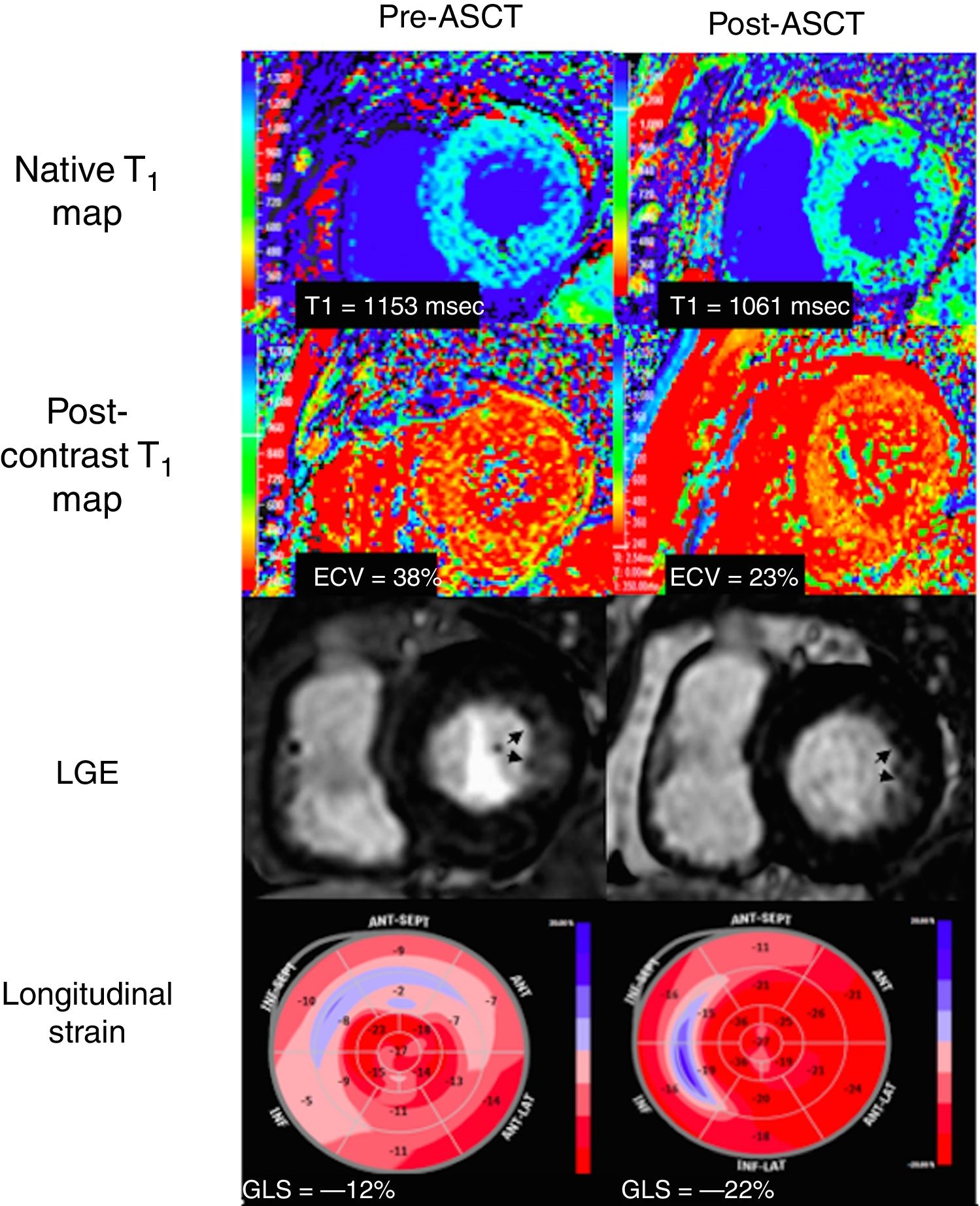 Regression of Cardiac Amyloidosis Following Autologous Stem Cell ...