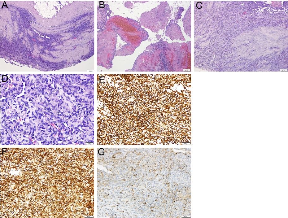 Right Atrium Angiosarcoma: An Unexpected Cause of Stroke | Revista ...