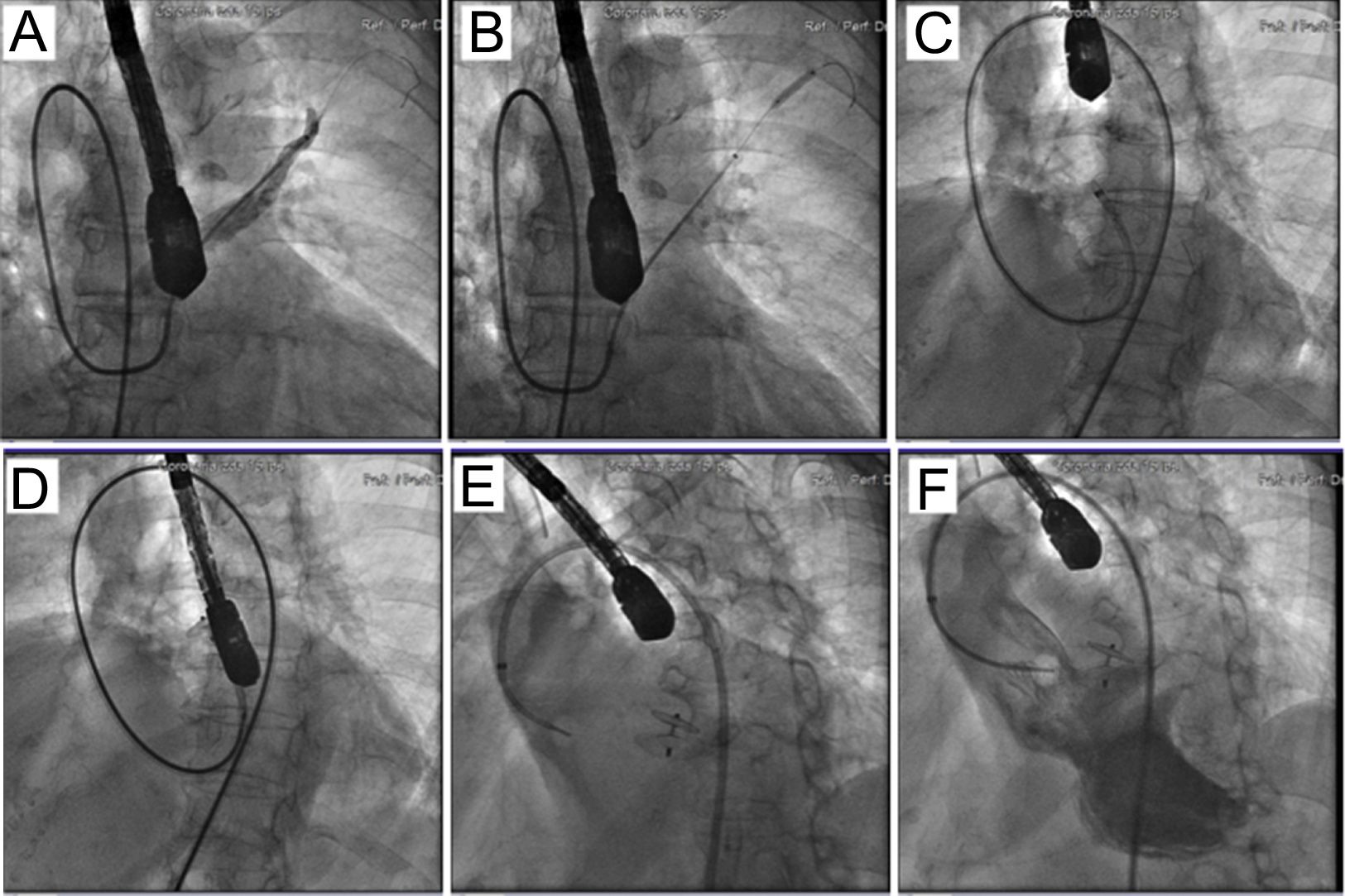 PFO With Platypnea-orthodeoxia in the Absence of Inferior Cava ...