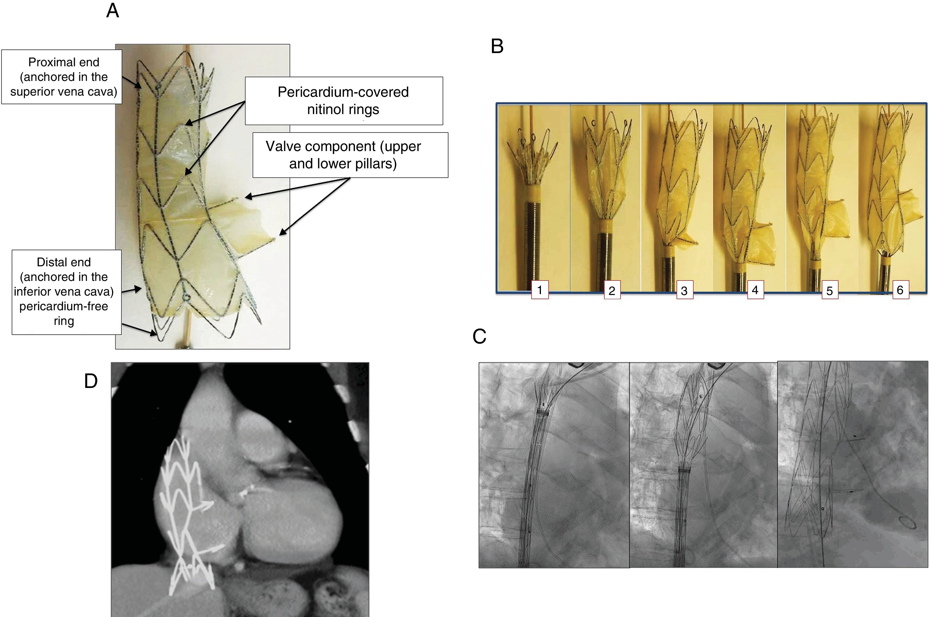 Percutaneous Tricuspid Valve Replacement Using a Valved Bioprosthesis ...