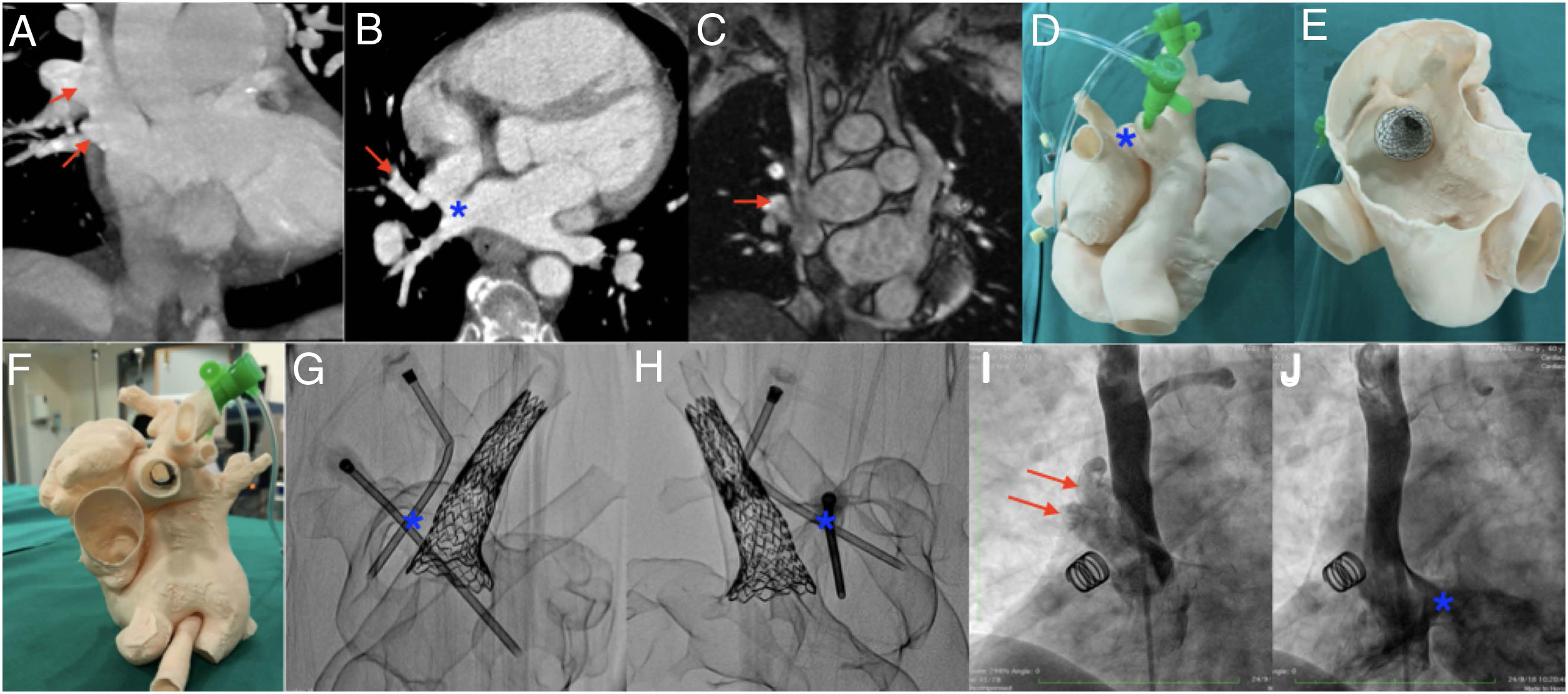 Transcatheter repair of superior sinus venosus atrial septal defect ...