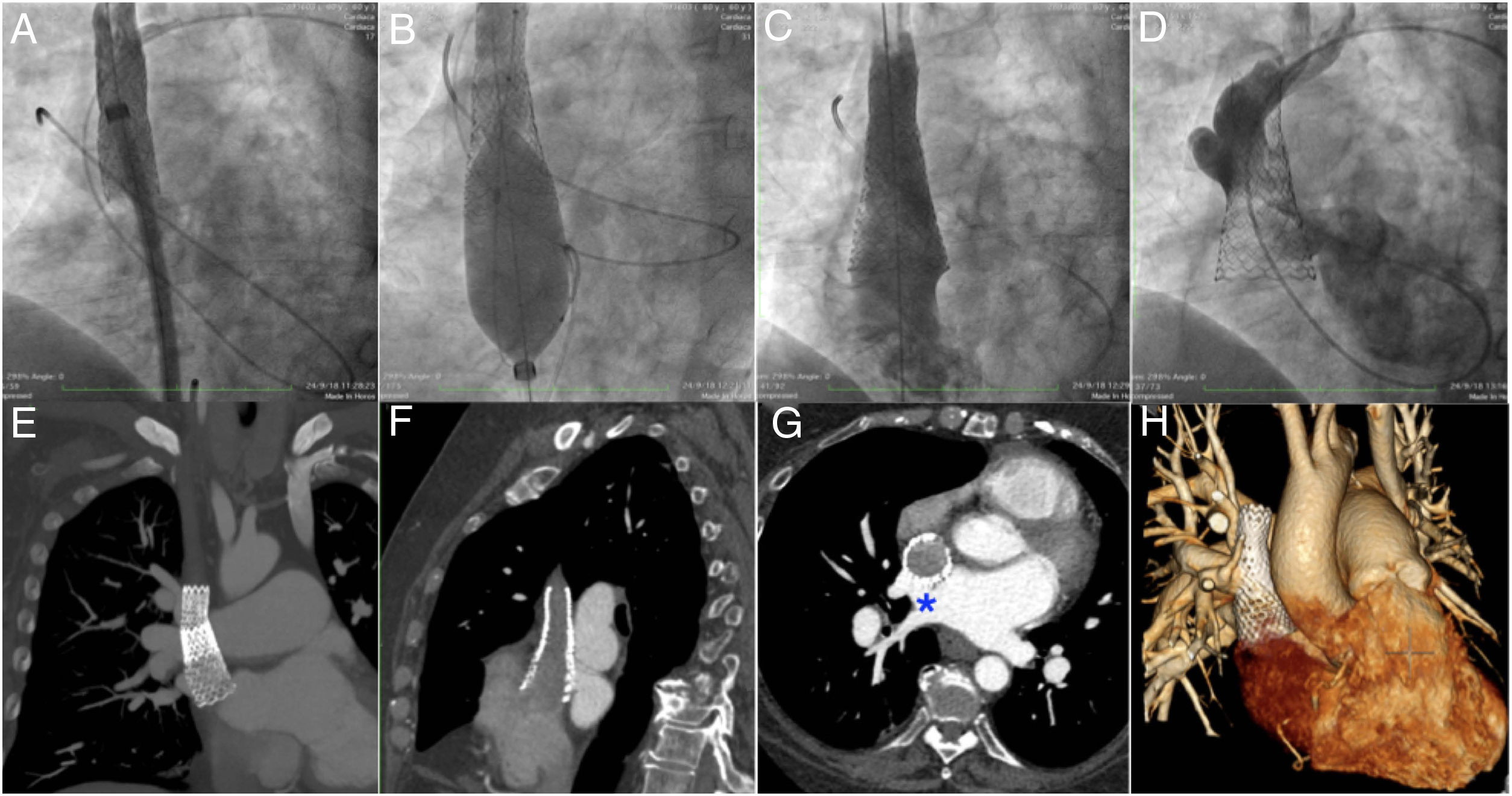 Transcatheter repair of superior sinus venosus atrial septal defect ...