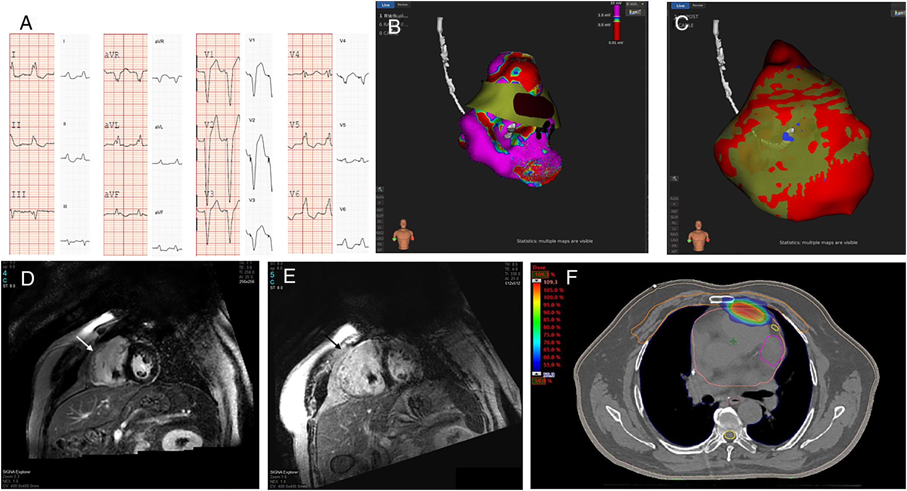 Noninvasive ablation of ventricular tachycardia with stereotactic ...