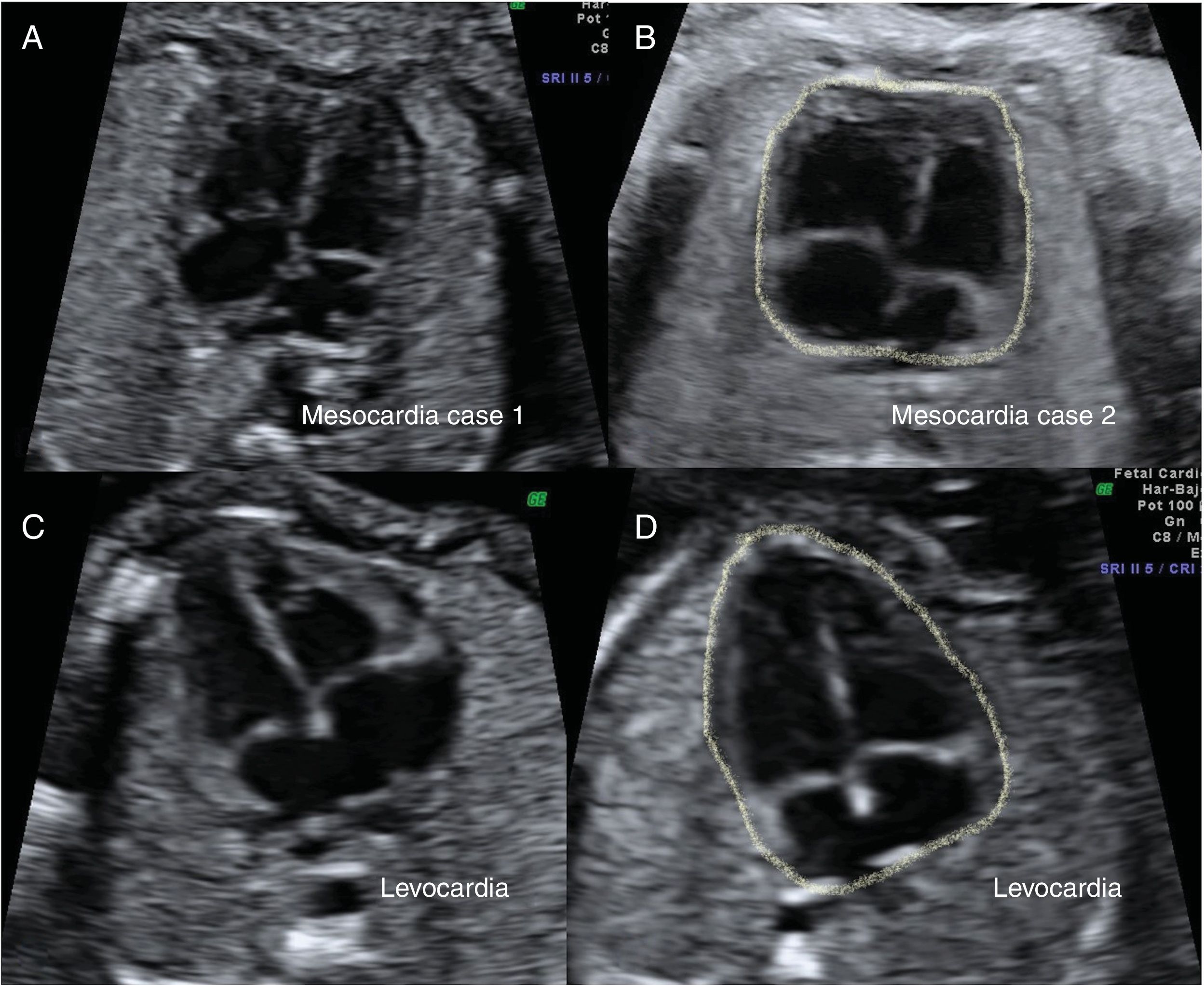 Echocardiographic features of fetal mesocardiac: a different heart ...