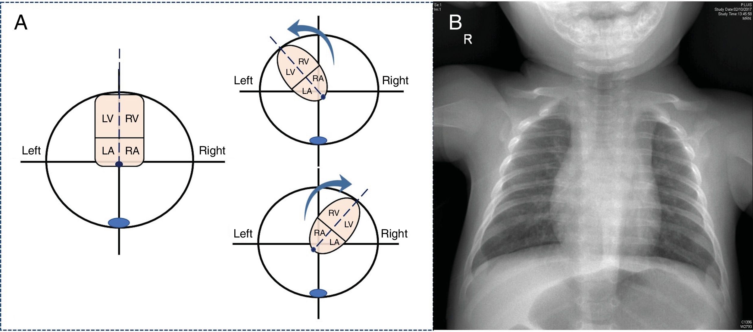 Echocardiographic features of fetal mesocardiac: a different heart ...