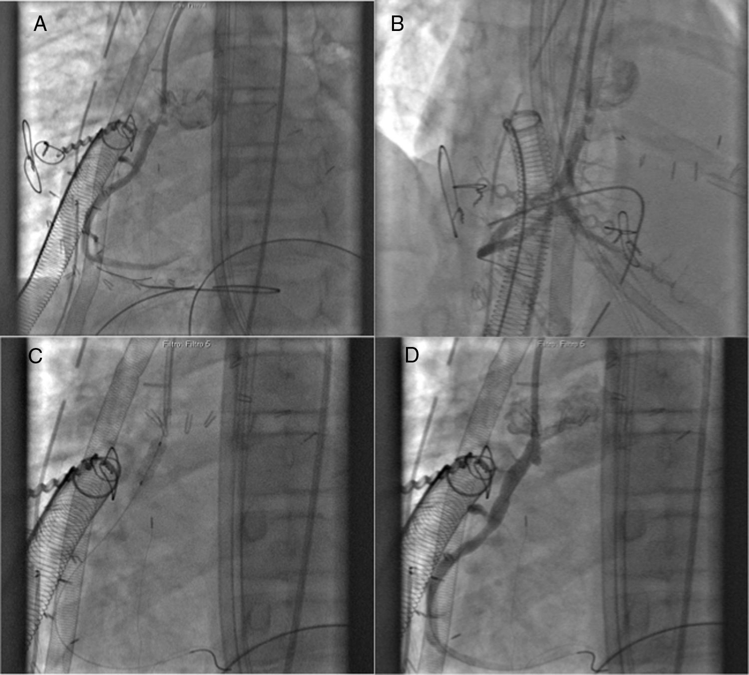 Experience of percutaneous coronary intervention in the pediatric and ...