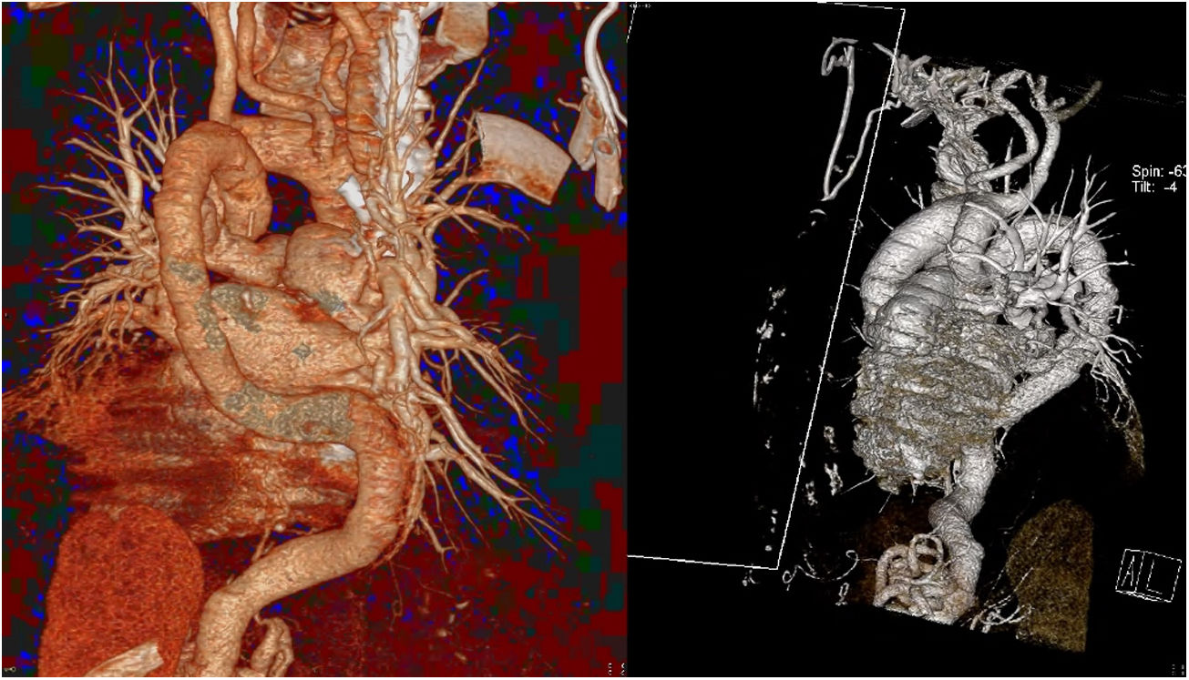 Arterial tortuosity syndrome: a late and unexpected diagnosis and ...