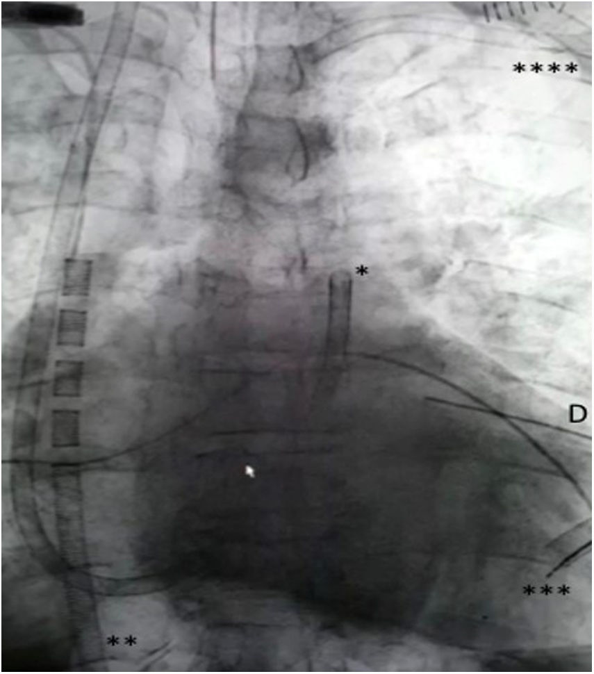 Minimally invasive approach for biventricular assist device with ...