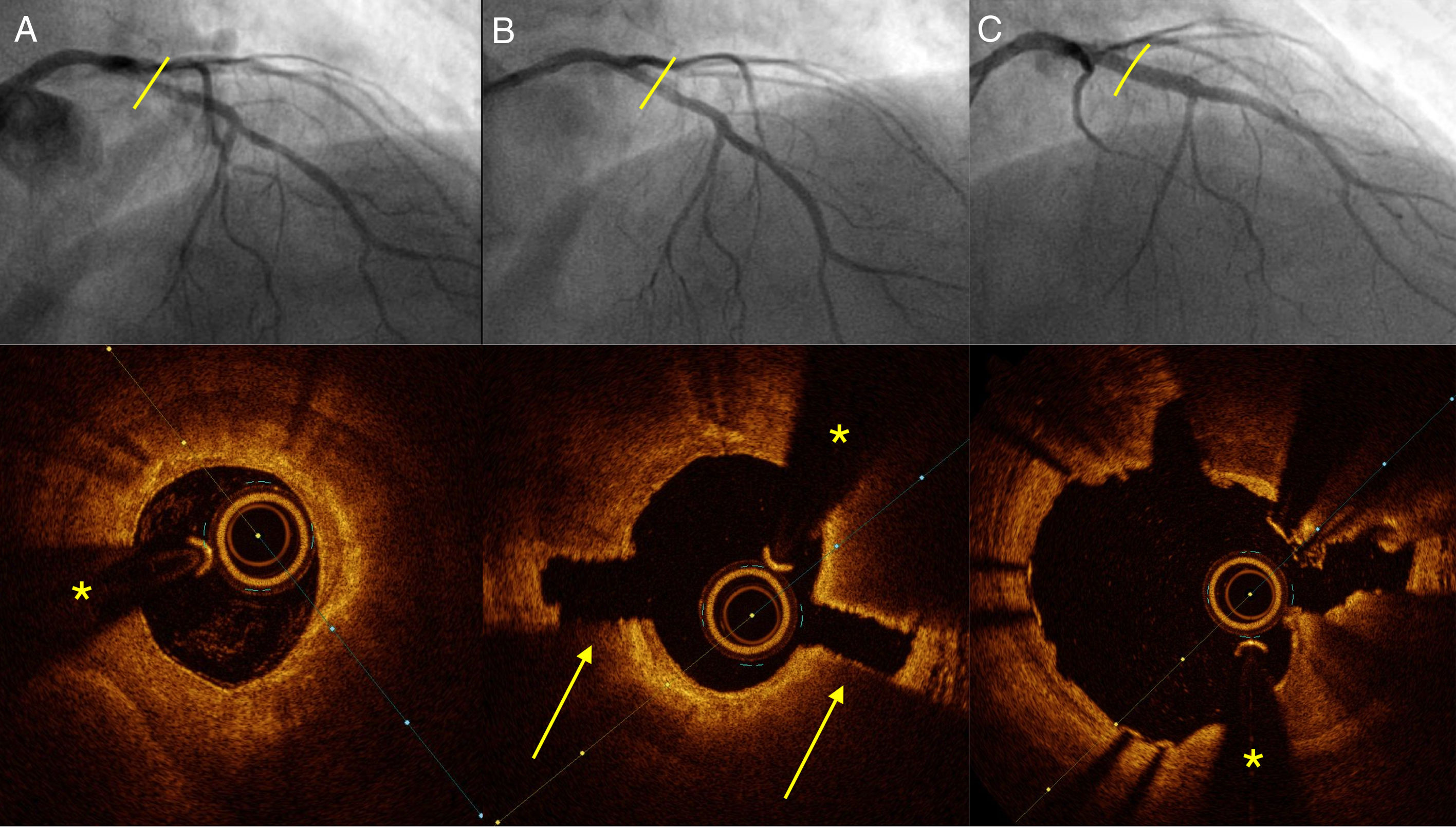 Deep circumferential calcium fracture after coronary lithotripsy ...