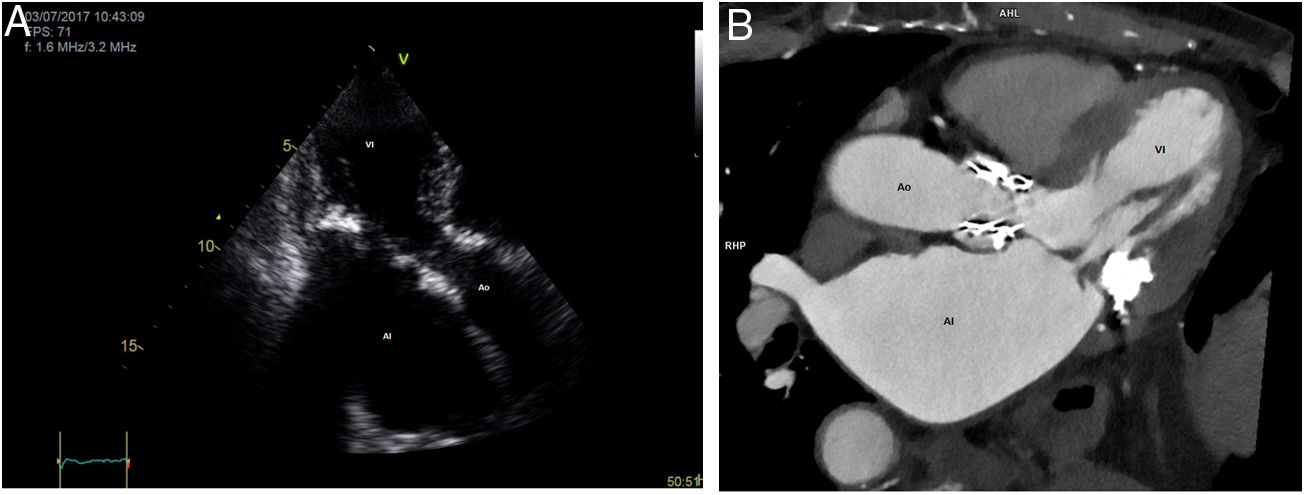 Modified LAMPOON technique - Revista Española de Cardiología (English ...