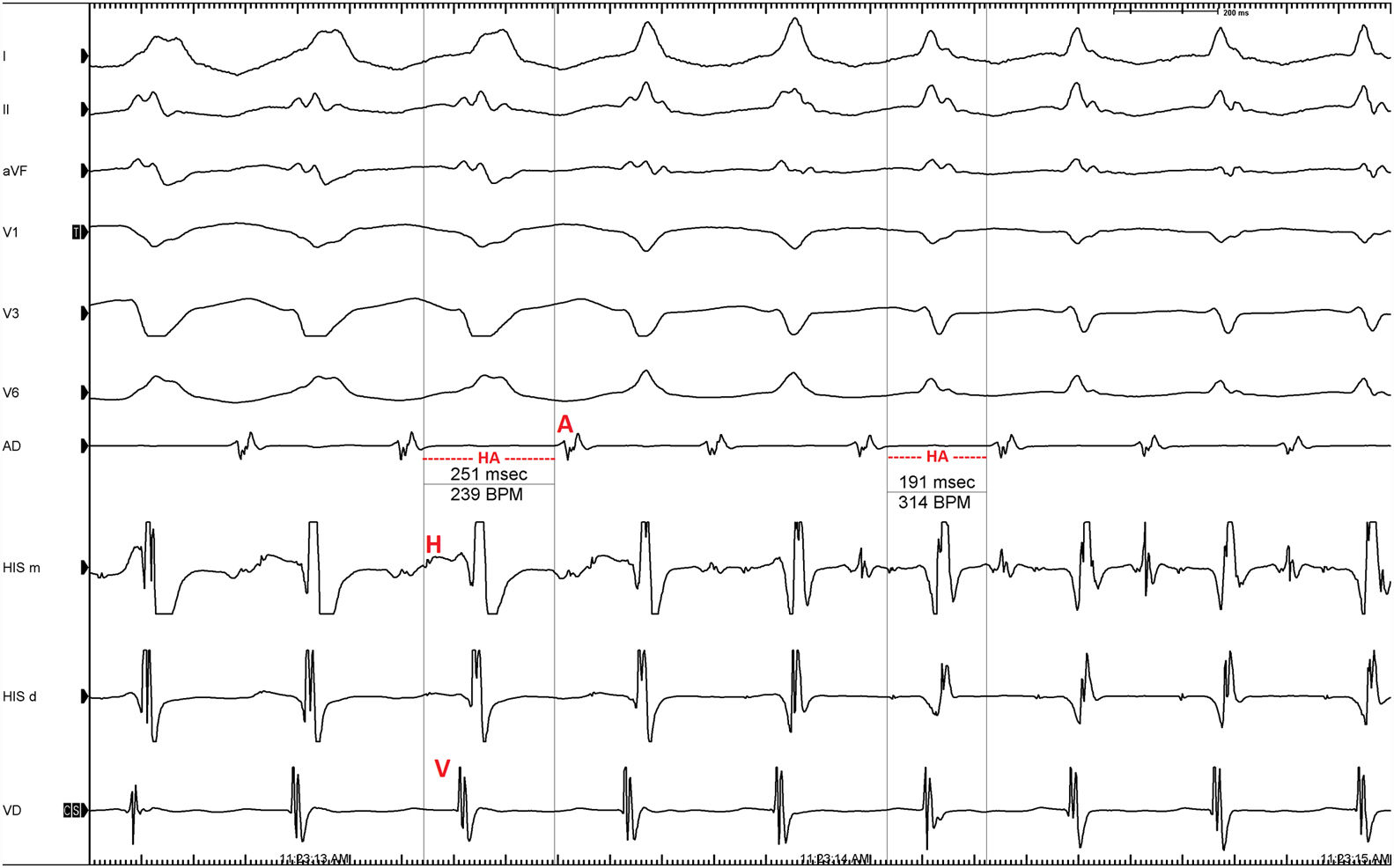 ECG, July 2020 | Revista Española de Cardiología