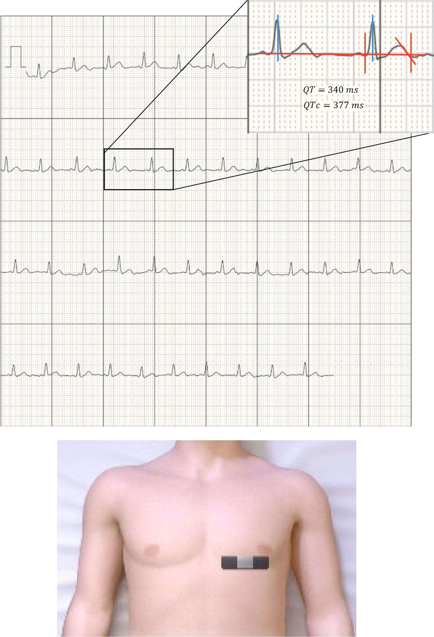 Electrocardiographic/QT interval monitoring with a portable device in ...