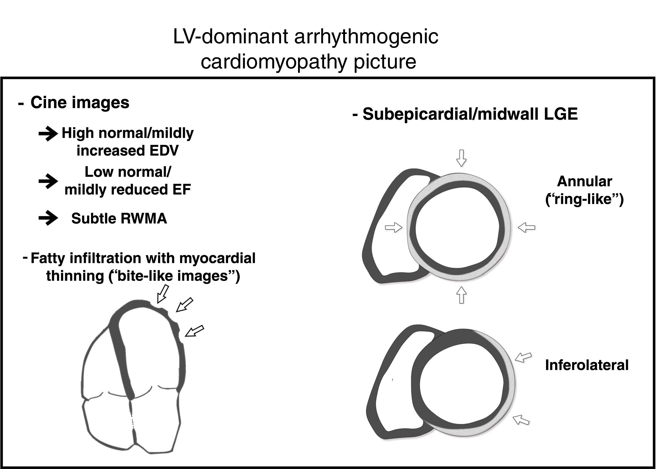 Cardiac magnetic resonance in arrhythmogenic cardiomyopathy: is it time ...