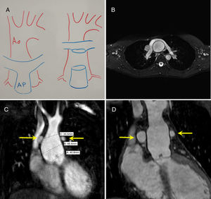 Aortic root surgery after arterial switch operation | Revista Española ...