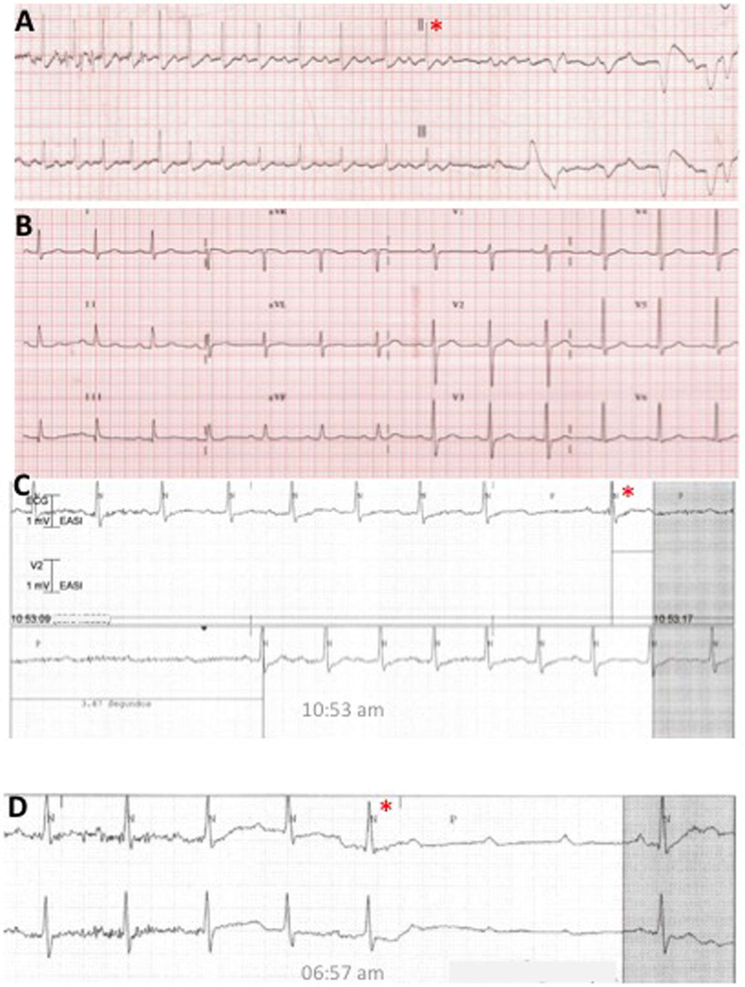 Endocardial autonomic denervation in a patient with neurally mediated ...