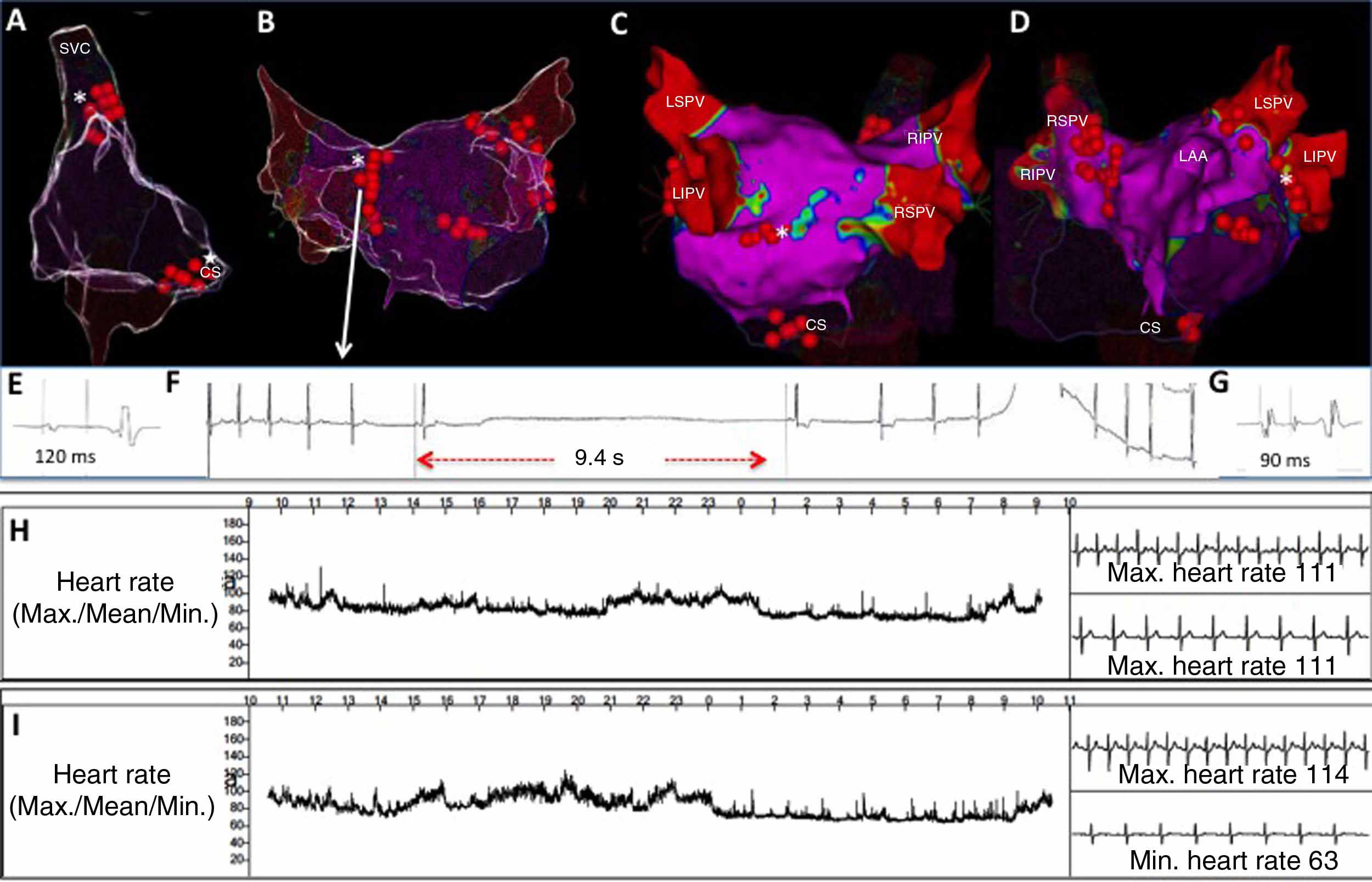 Endocardial autonomic denervation in a patient with neurally mediated ...