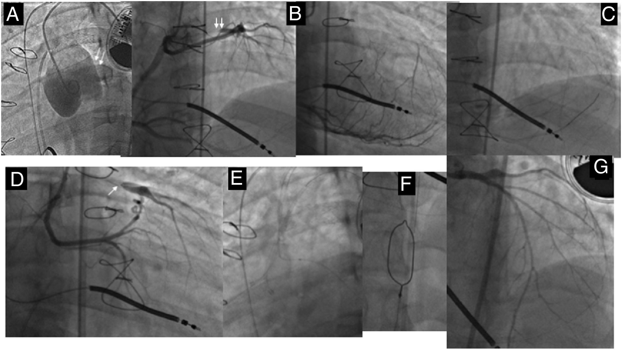 Percutaneous coronary intervention in aorto-ostial coronary chronic ...