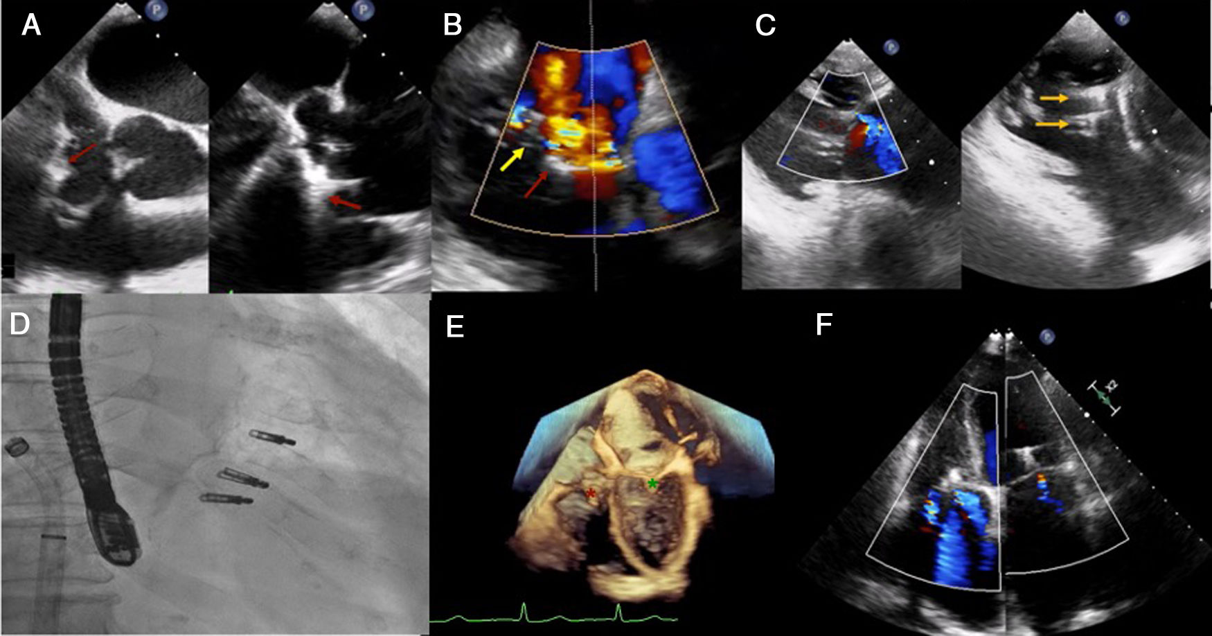 Combined transcatheter mitral and tricuspid repair with MitraClip ...