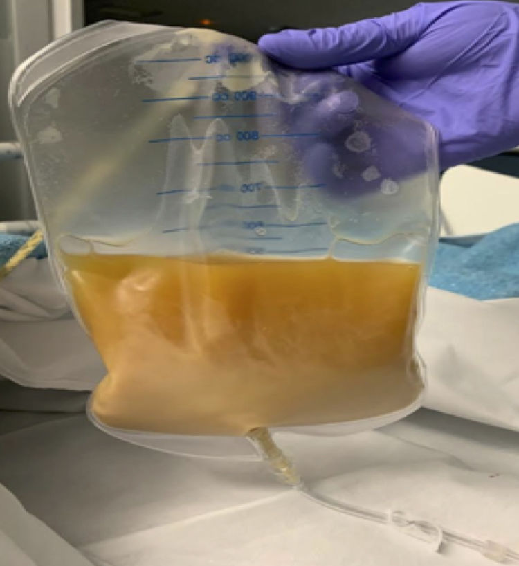 Pericardial variant of Austrian syndrome | Revista Española de Cardiología