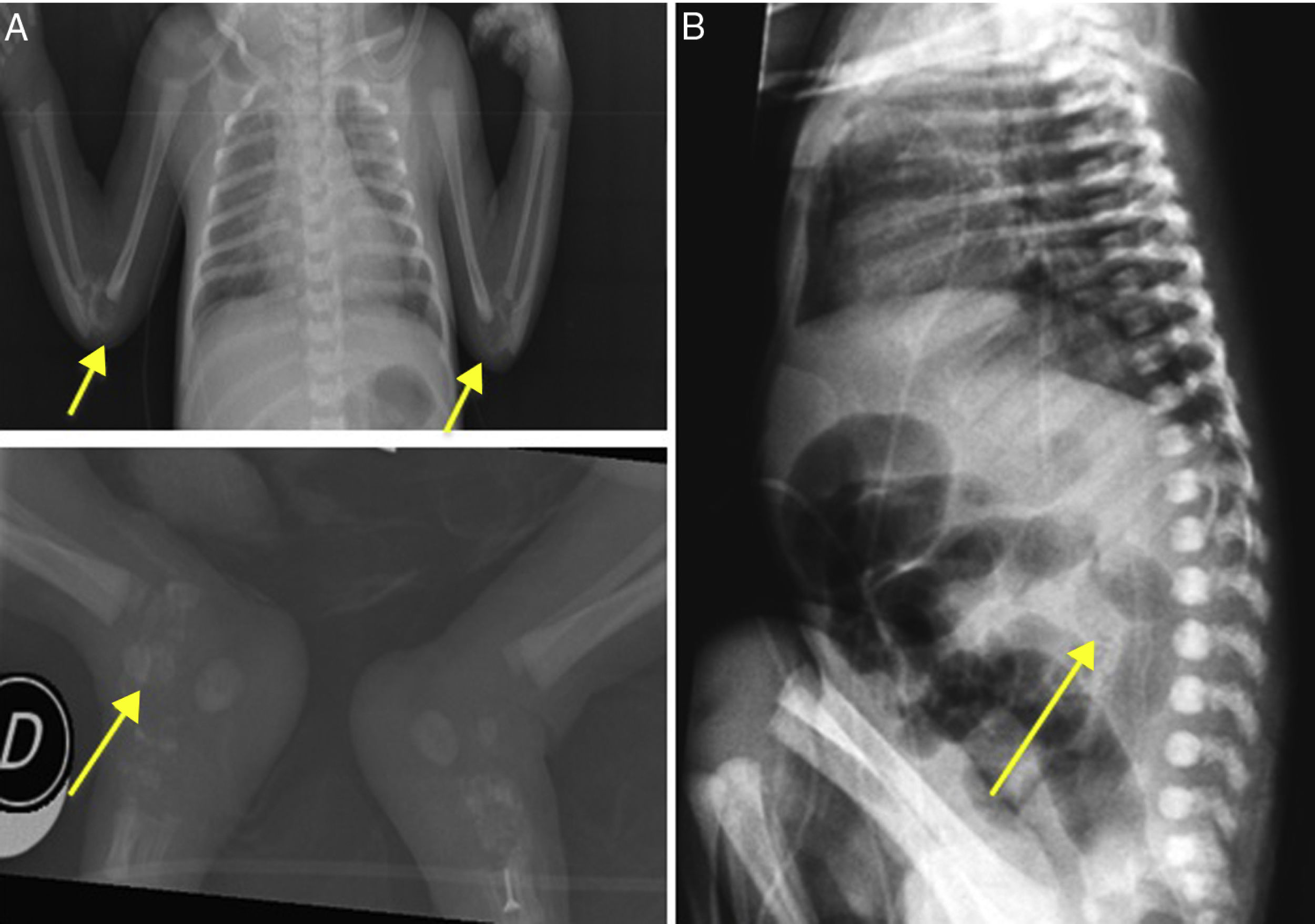 Neonatal myocardial ischemia and calcifications. Report of a case of ...