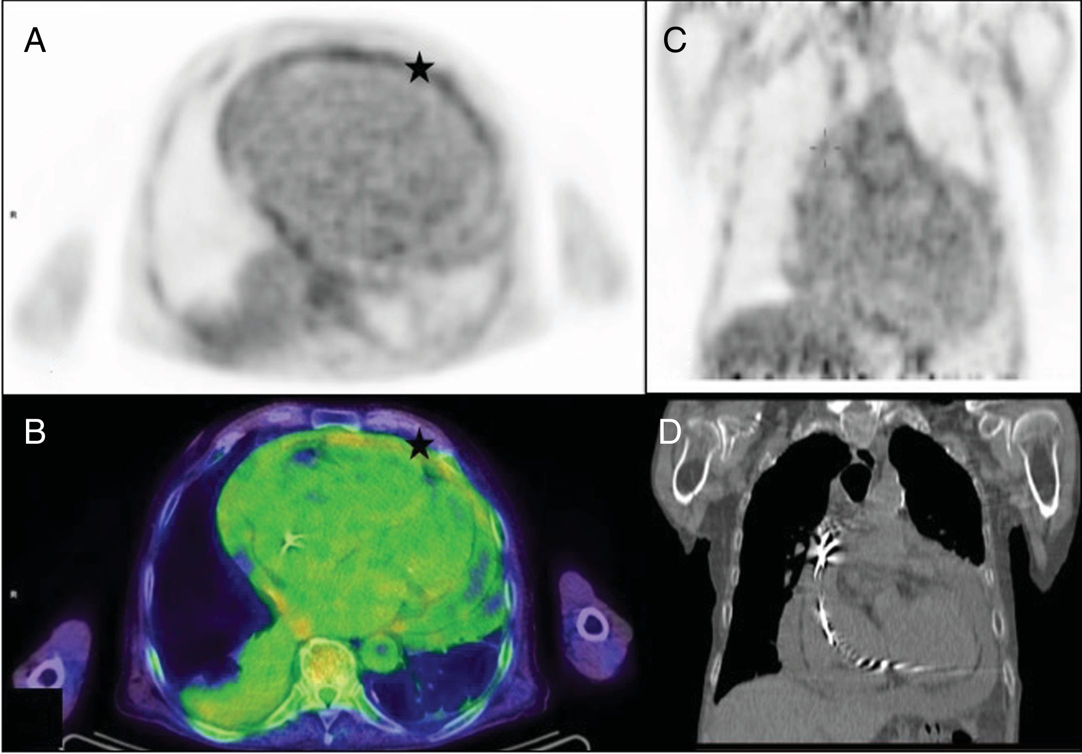 PET/CT with 18F-FDG in suspected intracardiac device-related infections ...