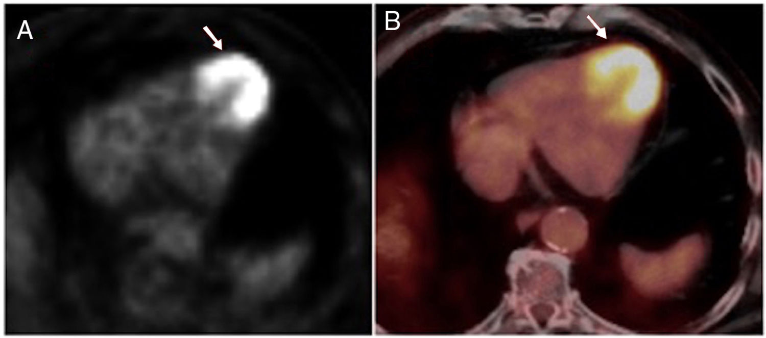 Metabolic “ace of spades” in apical hypertrophic cardiomyopathy ...