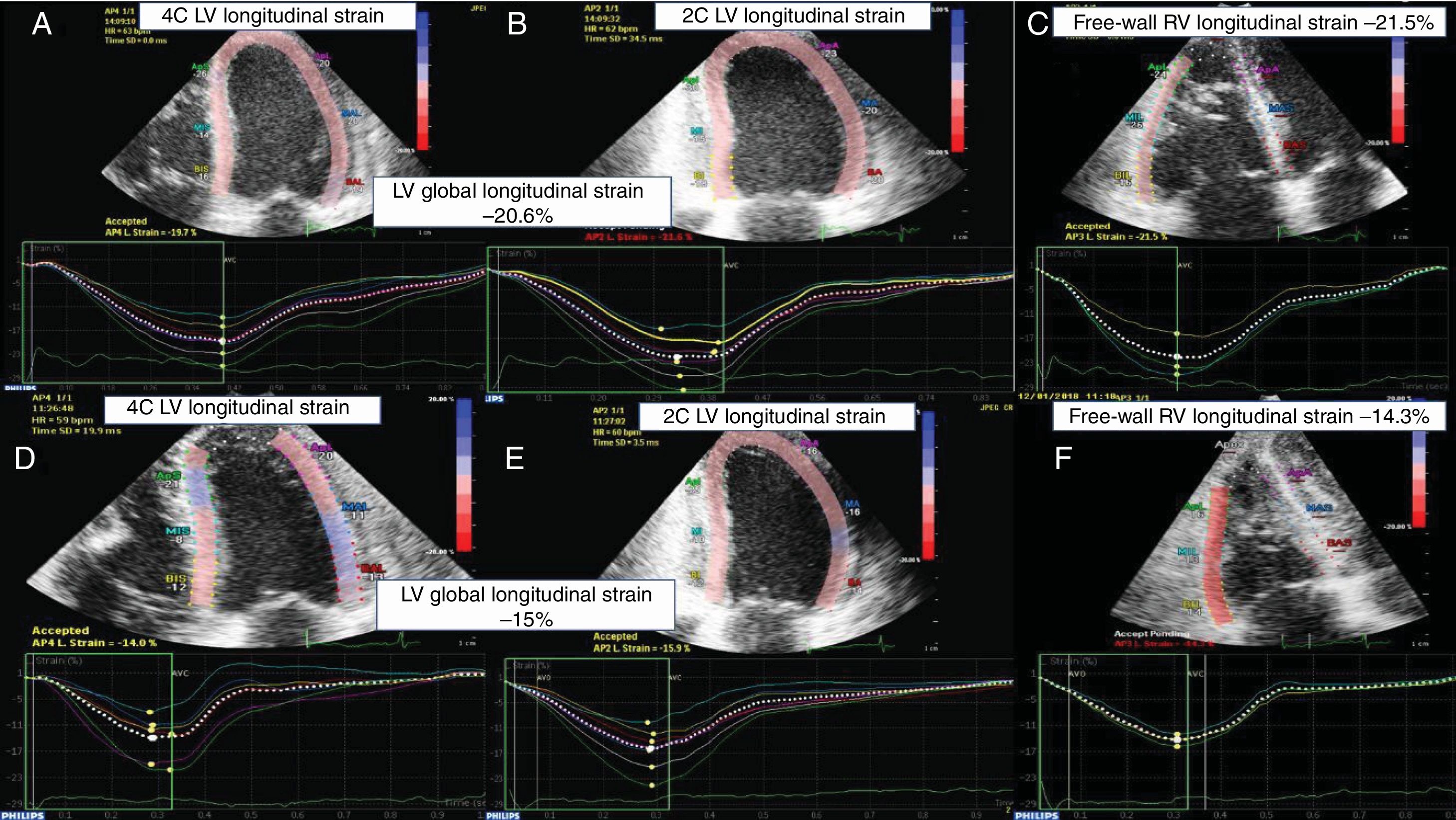 Validation of the usefulness of 2-dimensional strain parameters to ...