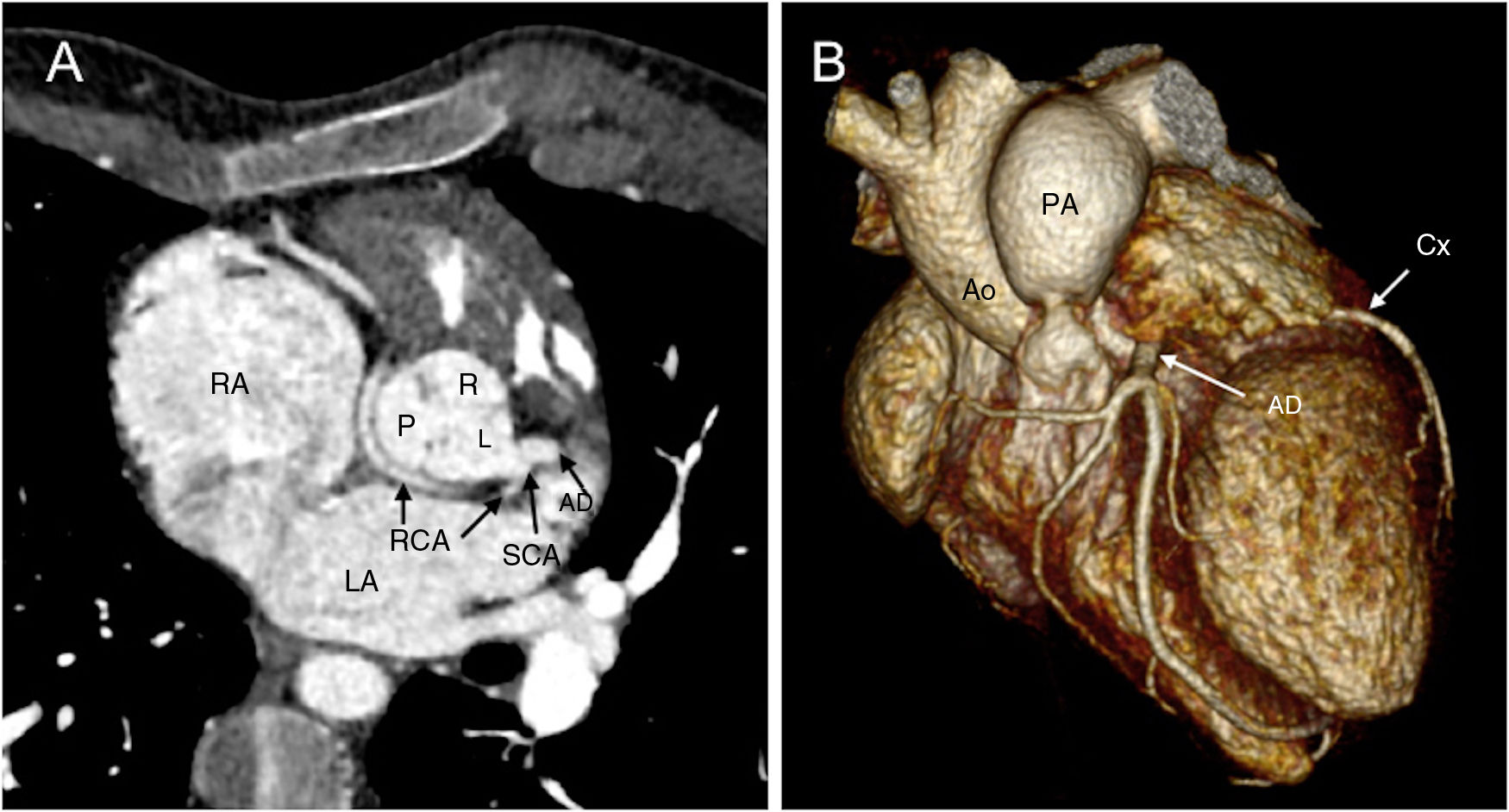 Infundibular pulmonary stenosis and single coronary artery | Revista ...