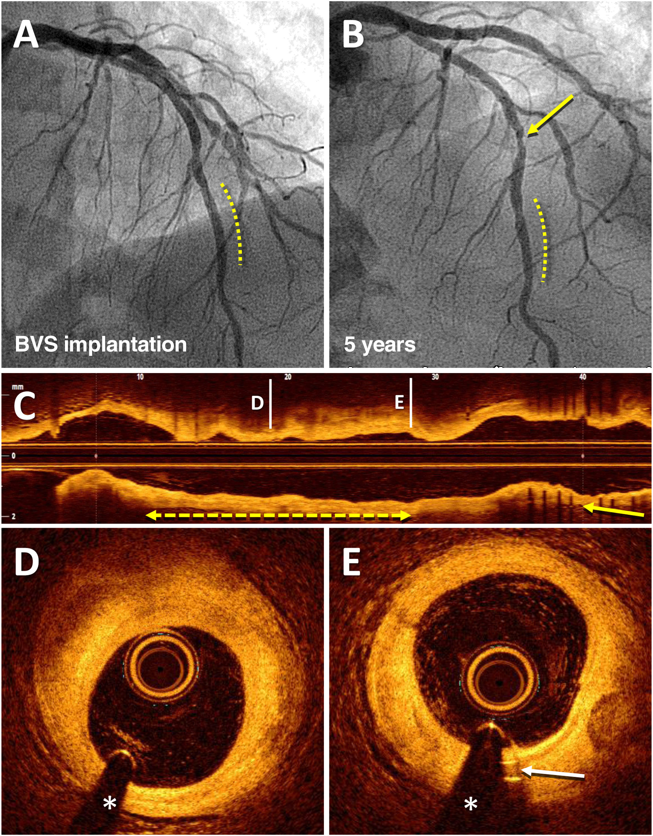 Coronary bioresorbable vascular scaffolds: requiescant in pace ...