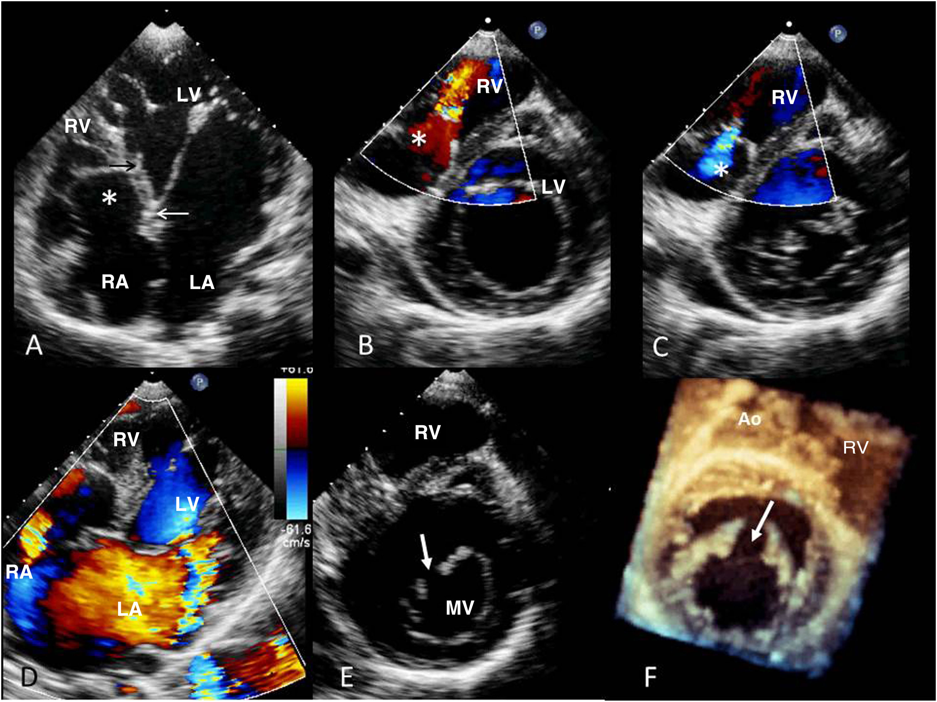 Uncommon mitral valve anomalies associated with Ebstein anomaly ...