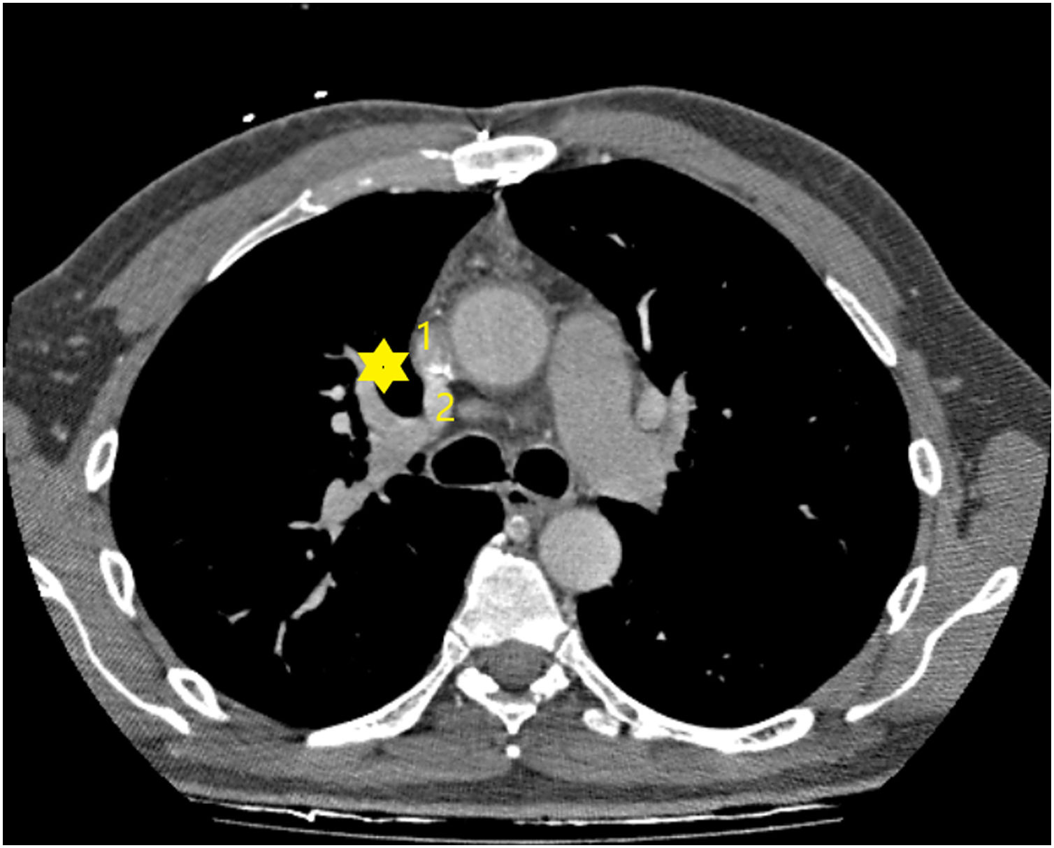 Percutaneous treatment of a surgical complication of sinus venosus ...