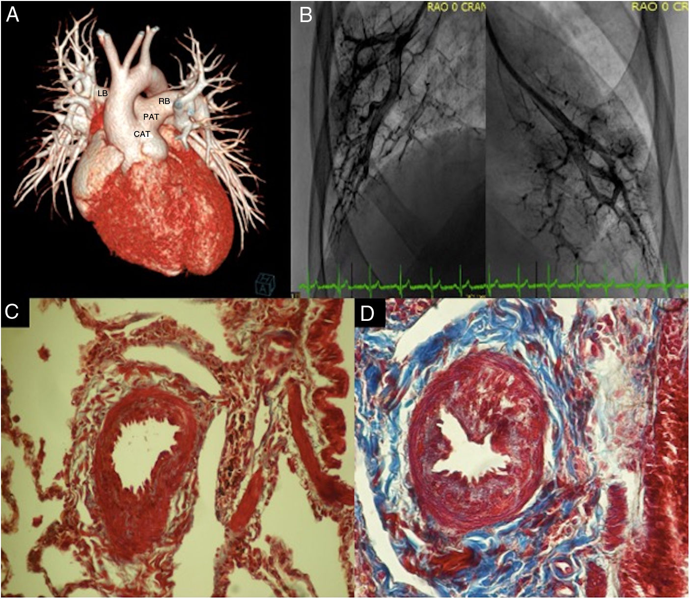 Common arterial trunk type I in a 15-year-old boy with grade I ...