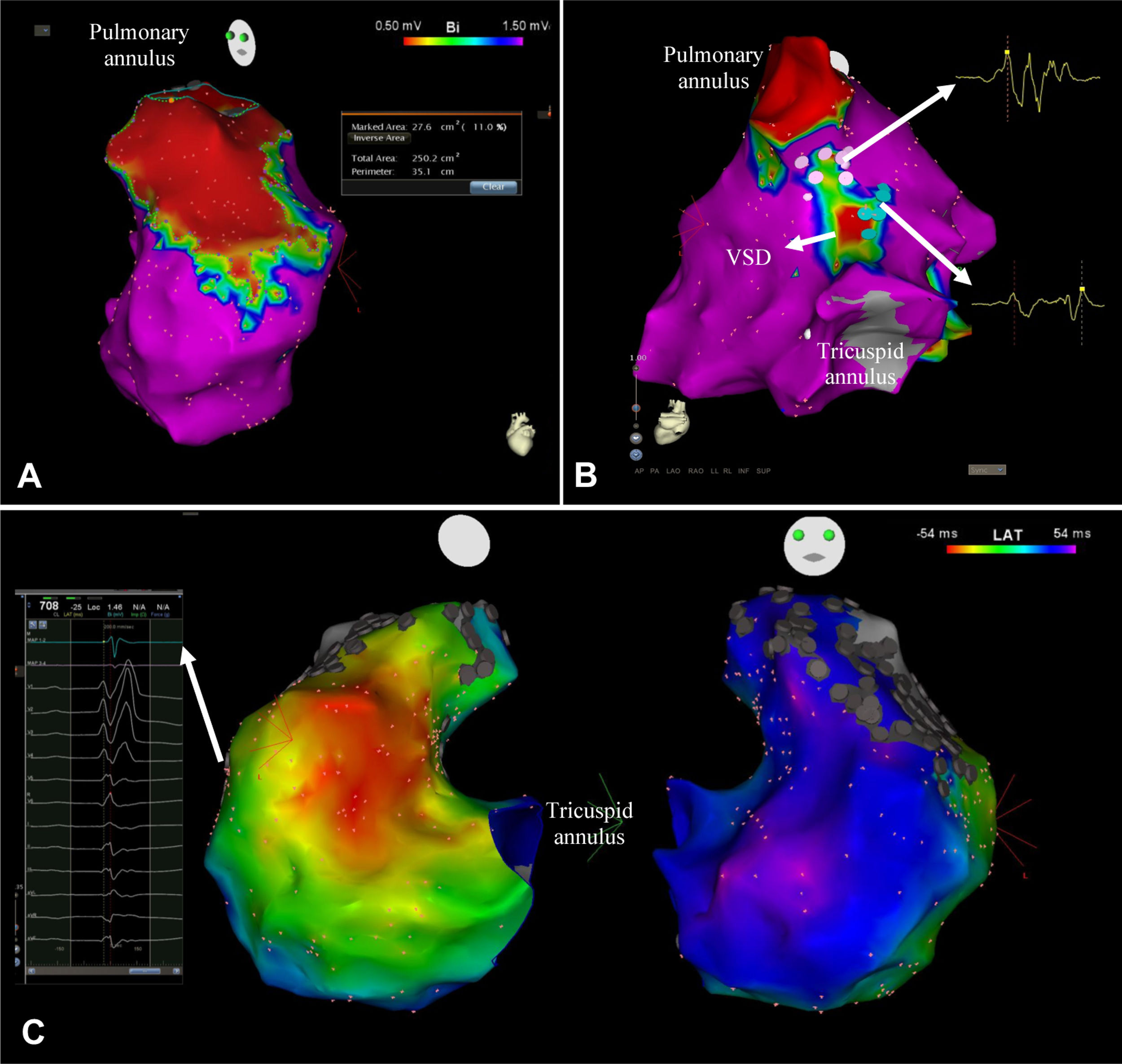 Risk stratification of ventricular arrhythmias in repaired tetralogy of ...