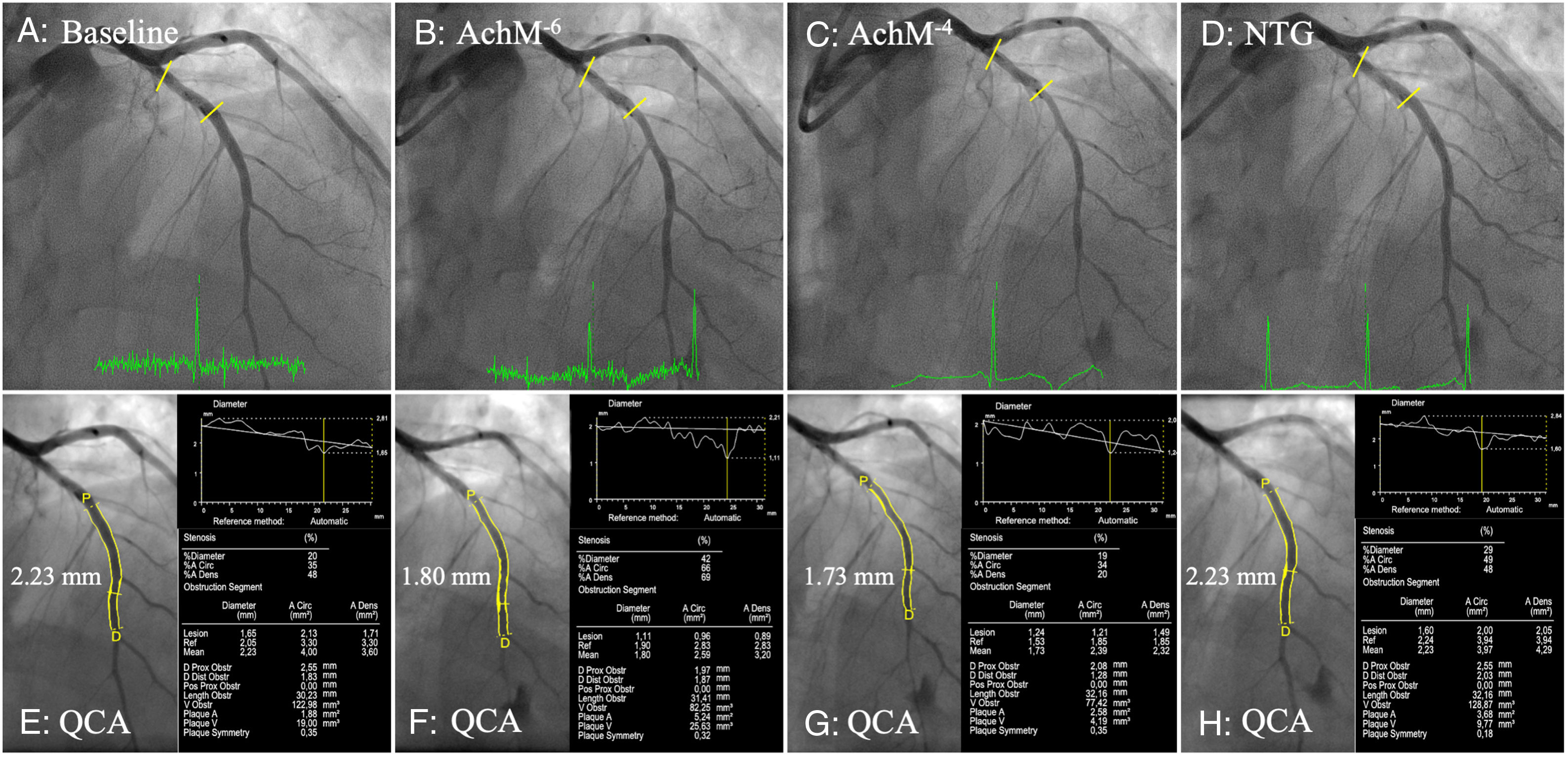 Coronary endothelial and microvascular function distal to polymer-free ...