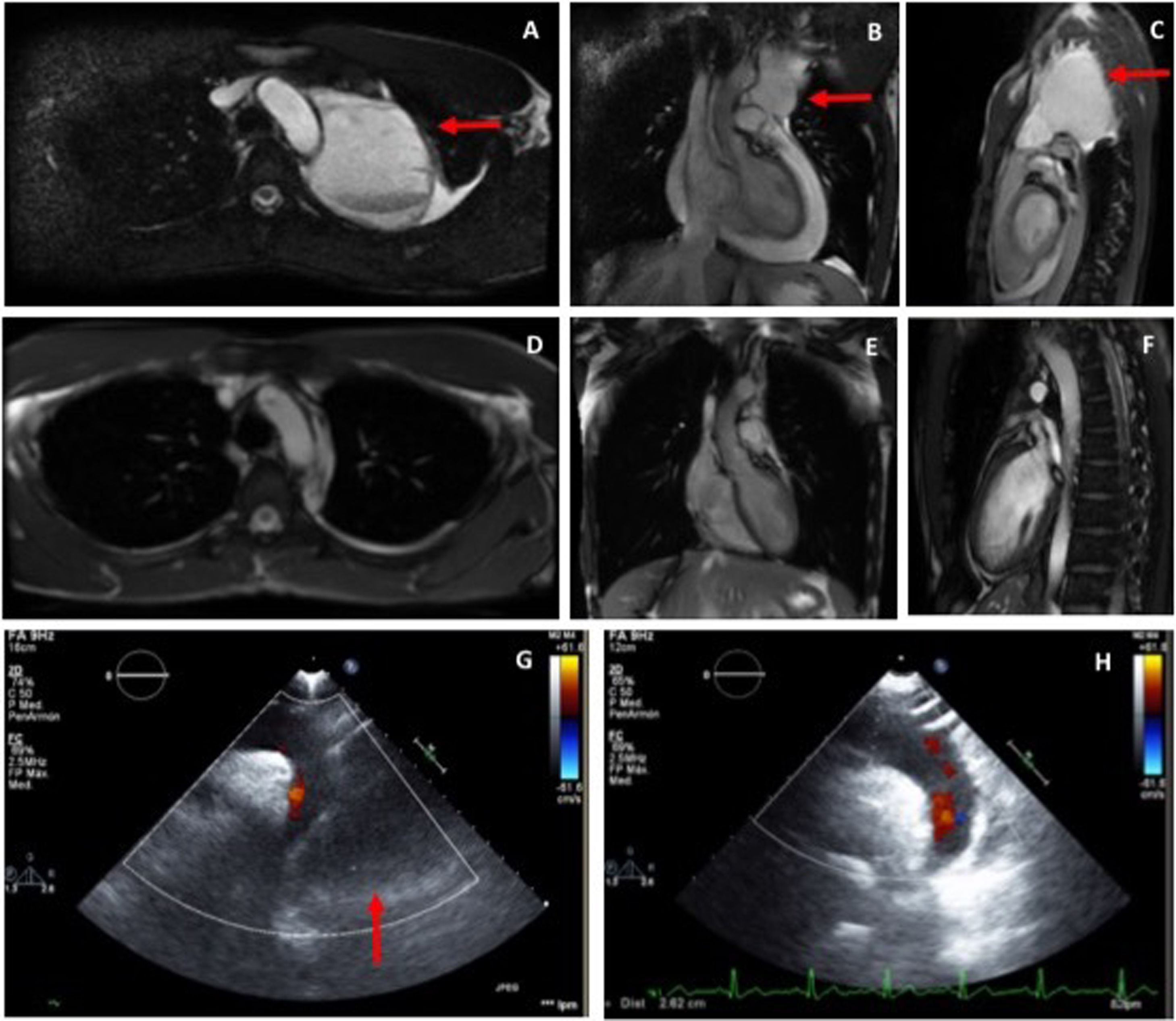 Complete resolution of atypical pericardial cyst after acute ...