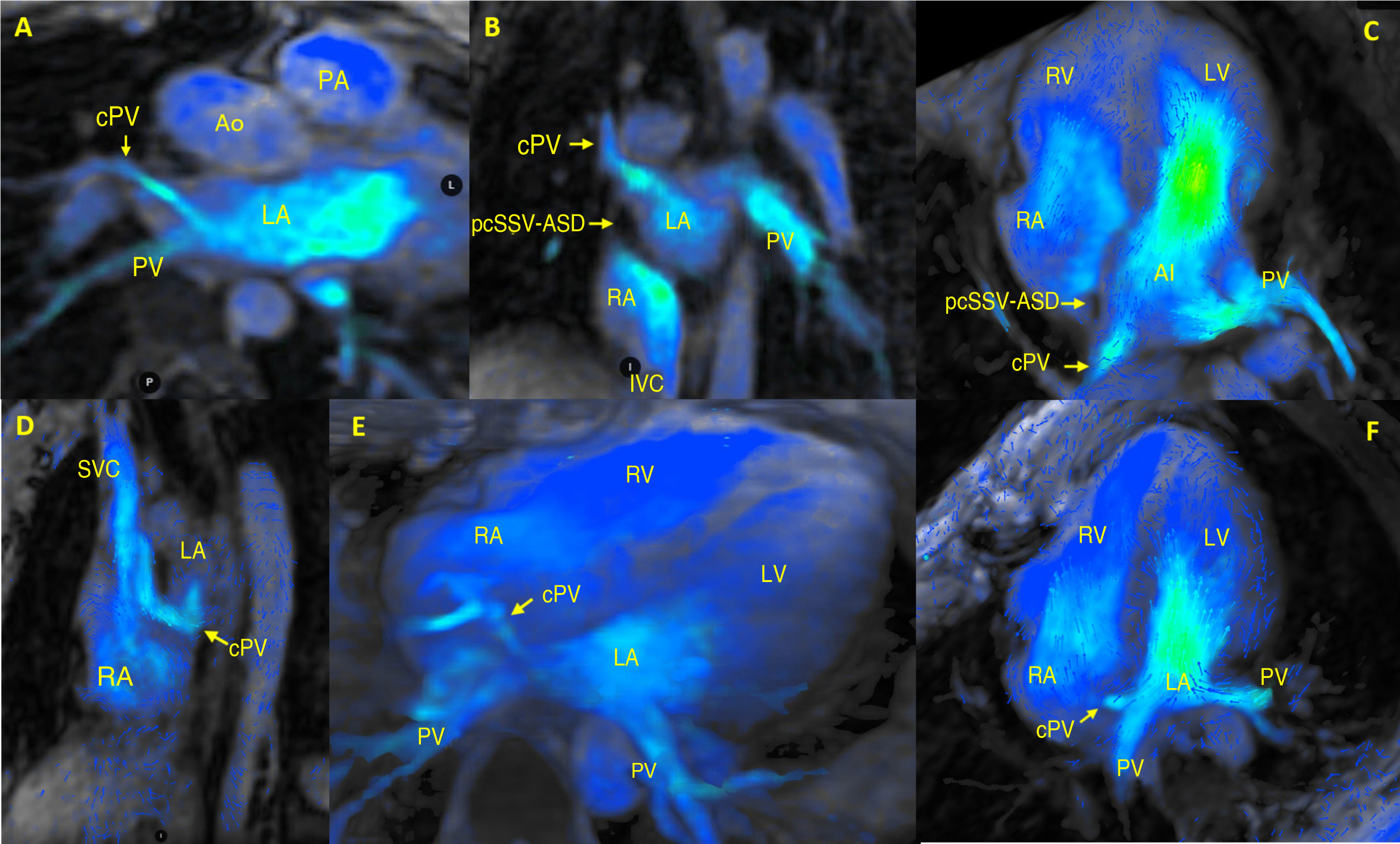 Cardiac magnetic resonance with 4D-flow in pre- and postcorrection ...