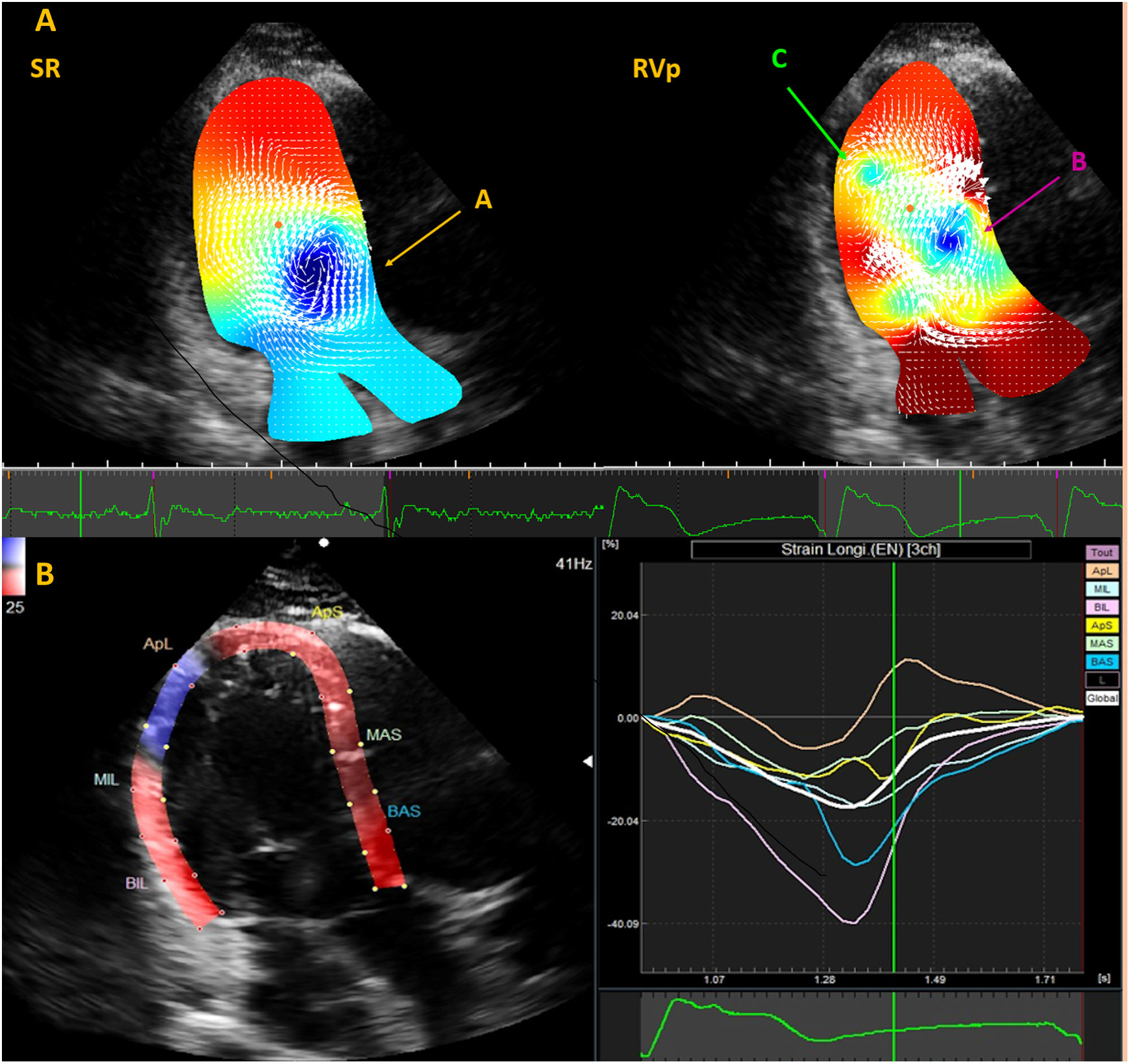 Vector flow mapping analysis in a child with a cardiac ...