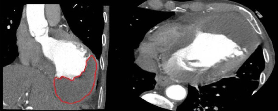 Apixaban and intraventricular thrombus resolution in a patient with an ...