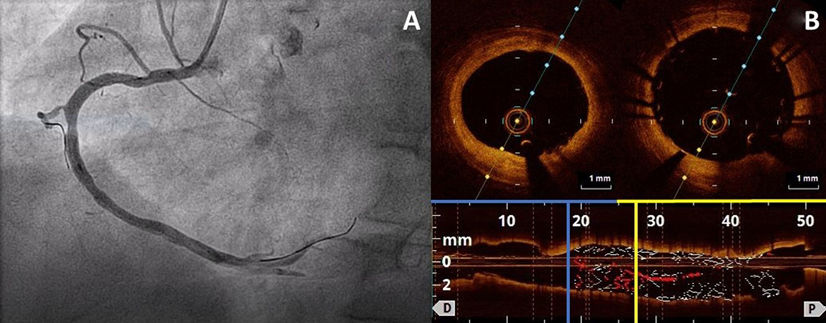 Vasospasm-related stent malapposition in acute coronary syndrome ...