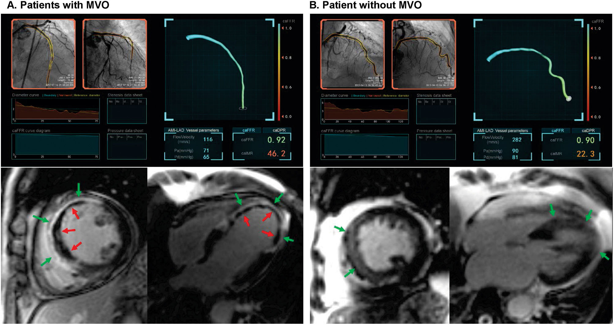 Functional angiography-derived index of microcirculatory resistance ...