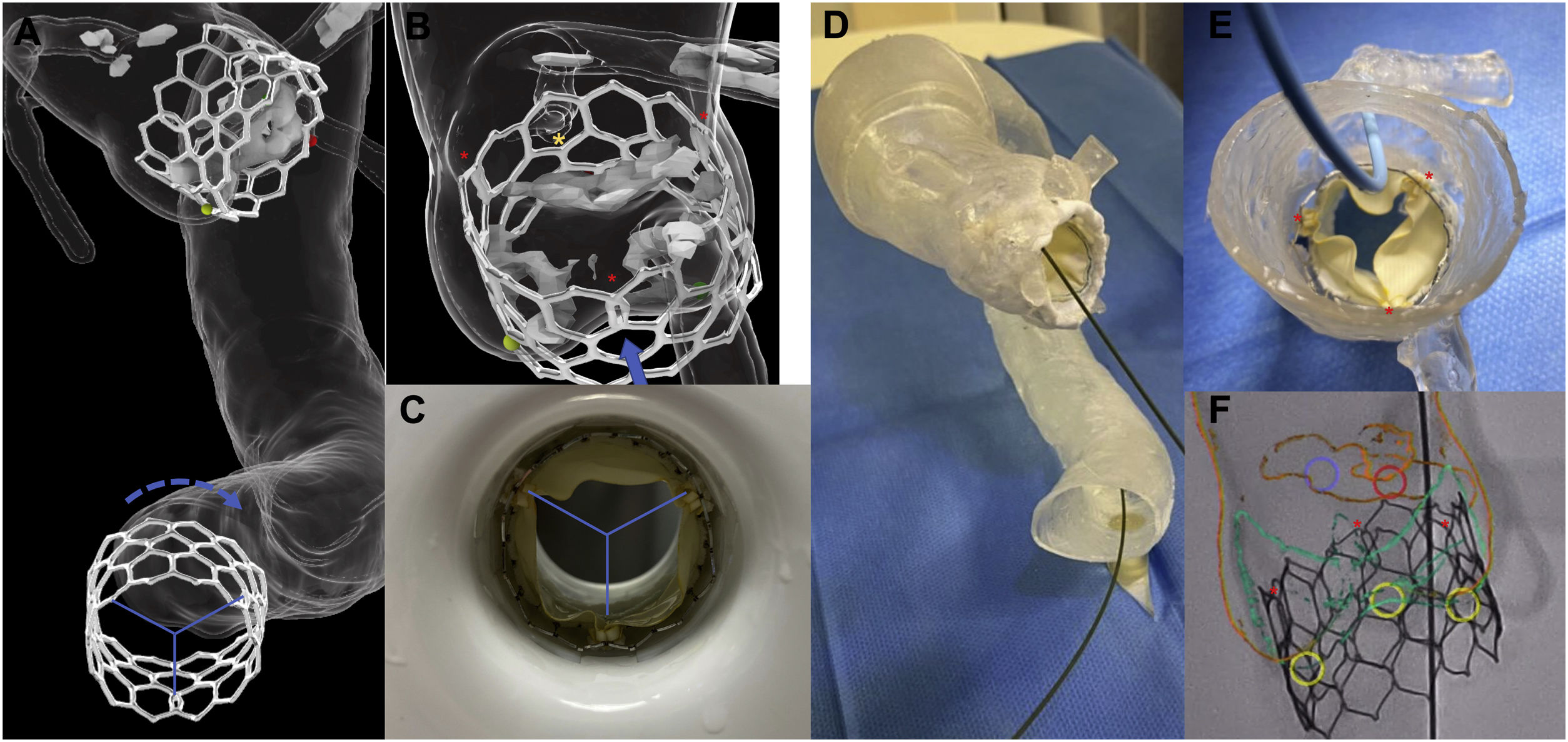 Feasibility of precise commissural and coronary alignment with balloon ...
