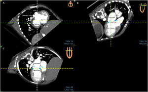 Cardiac tomography-echocardiography imaging fusion: a new approach to ...